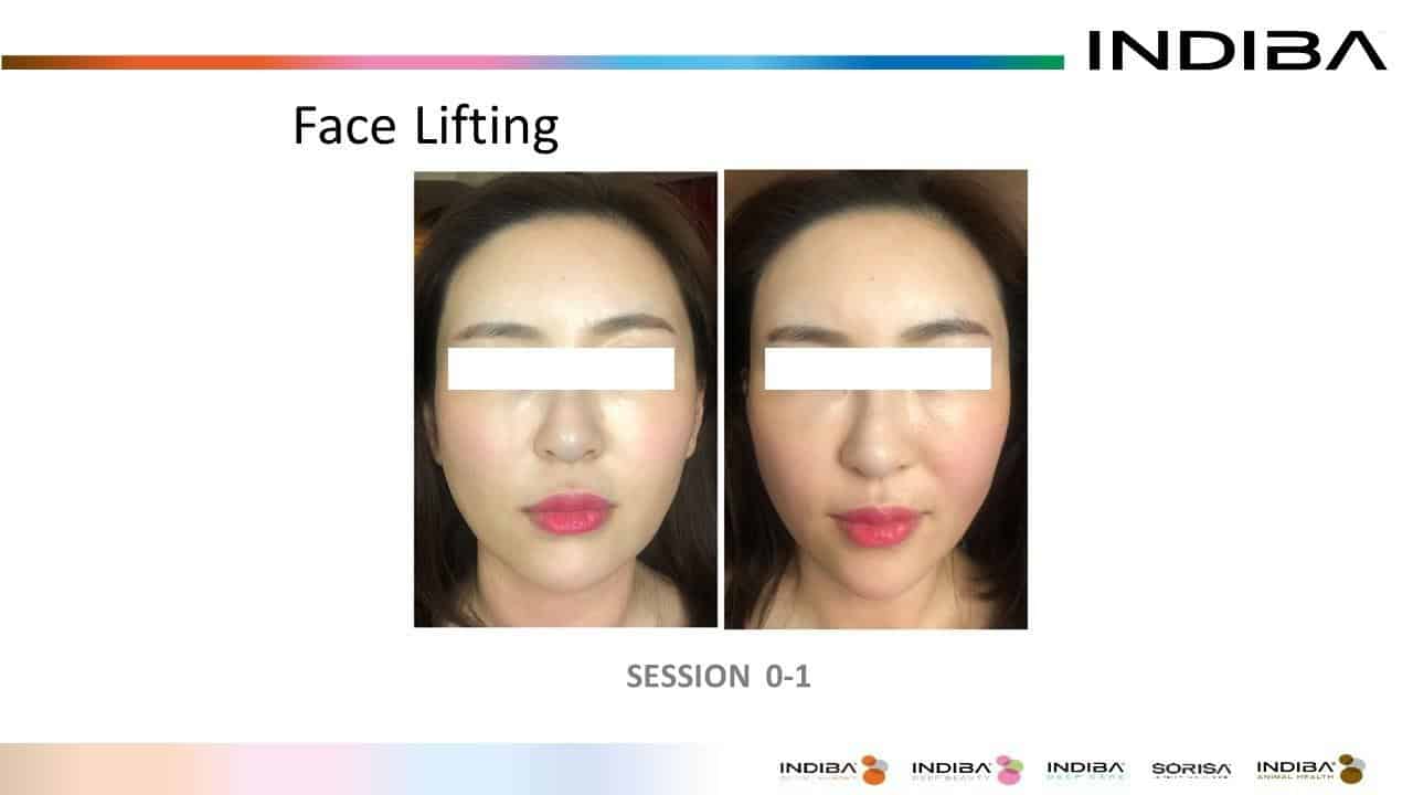 Indiba Skin Tightening Siam Clinic - Aesthetic & Wellness Clinic in Phuket