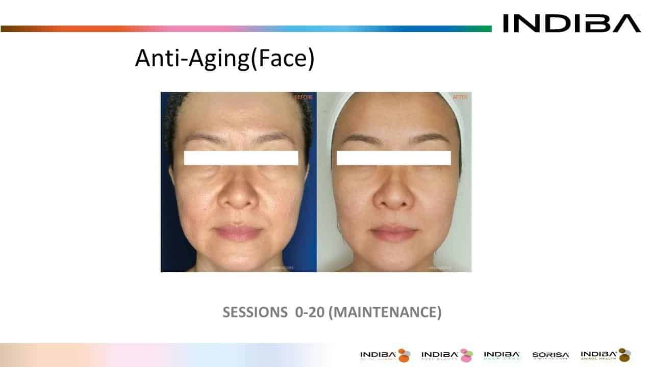 Indiba Skin Tightening Siam Clinic - Aesthetic & Wellness Clinic in Phuket