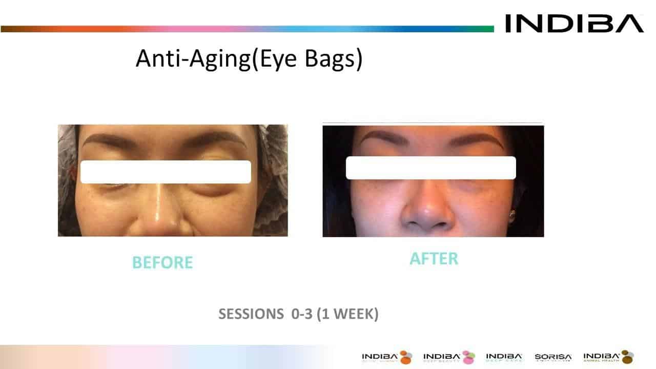 Indiba Skin Tightening Siam Clinic - Aesthetic & Wellness Clinic in Phuket