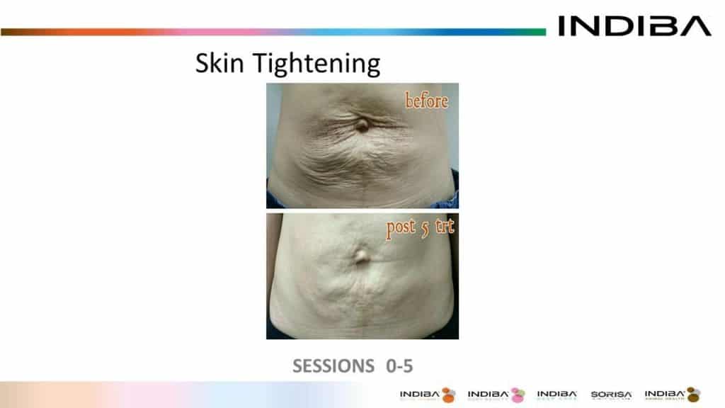 Indiba Skin Tightening Siam Clinic - Aesthetic & Wellness Clinic in Phuket