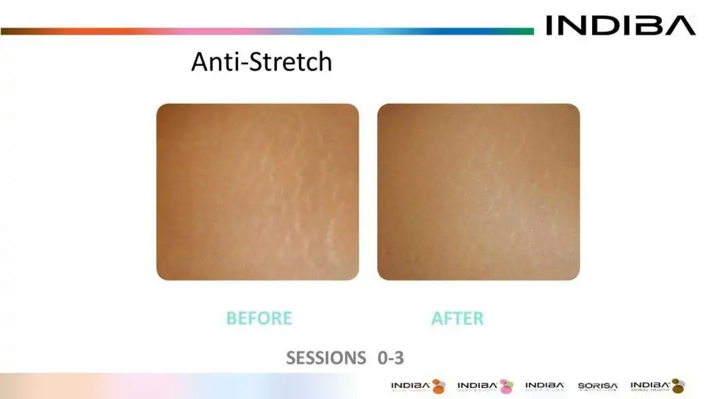 Indiba Skin Tightening Siam Clinic - Aesthetic & Wellness Clinic in Phuket