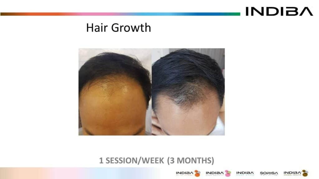 Indiba Skin Tightening Siam Clinic - Aesthetic & Wellness Clinic in Phuket