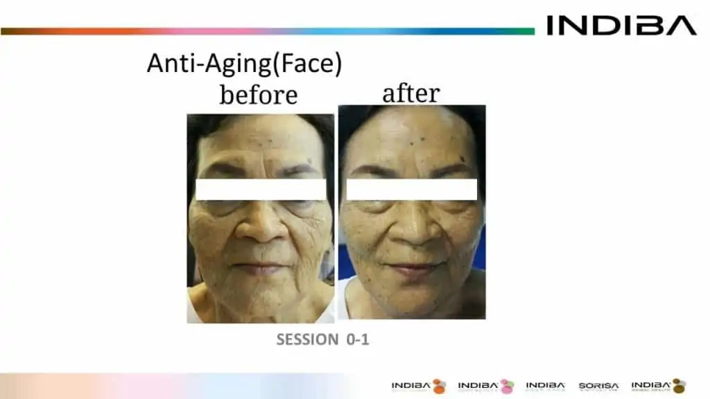 Indiba Skin Tightening Siam Clinic - Aesthetic & Wellness Clinic in Phuket