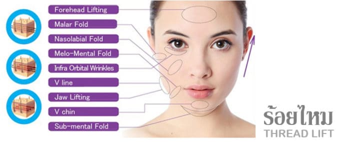 Jawline Thread lifting - Siam Clinic - Aesthetic & Wellness Clinic in ...