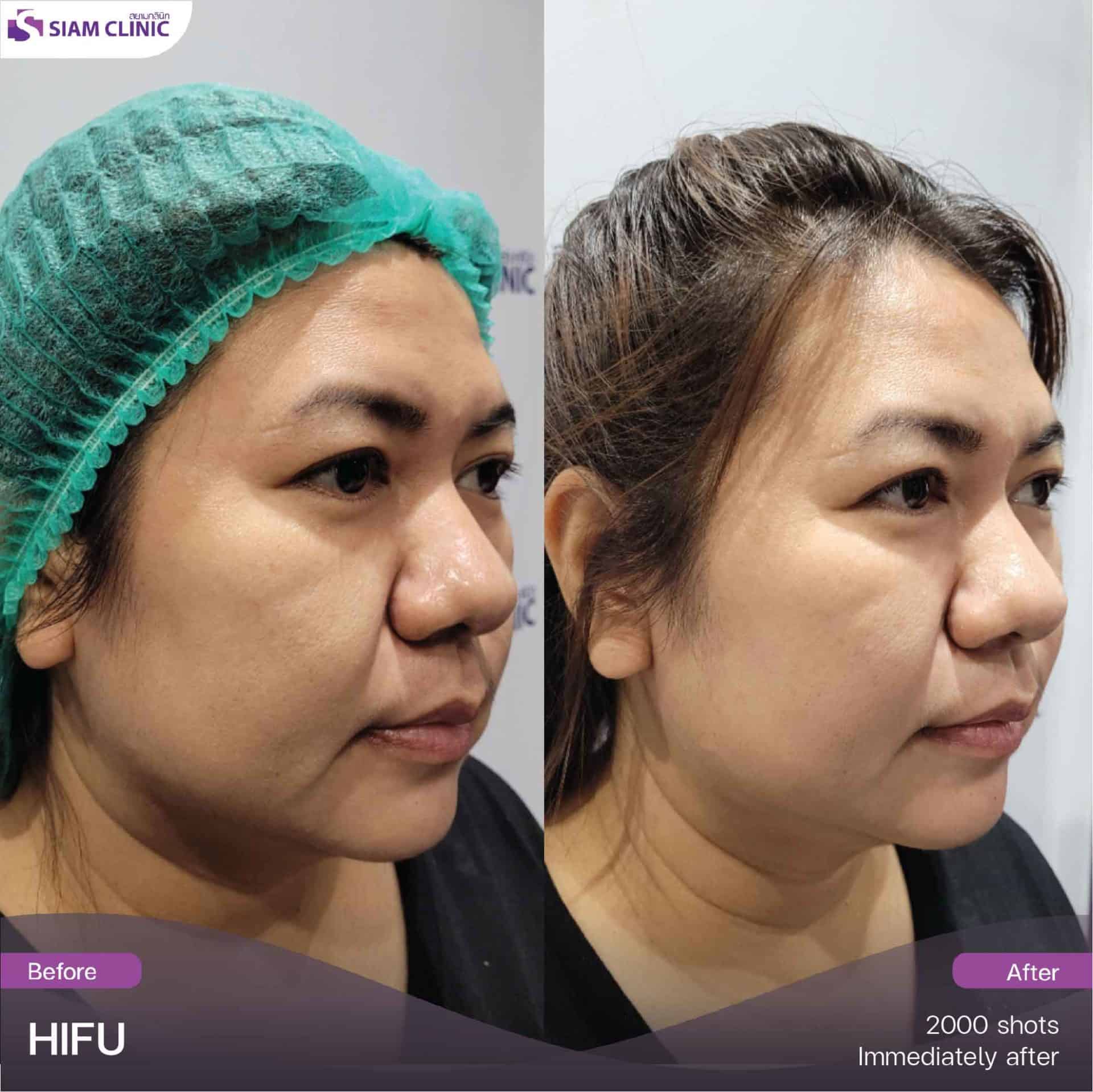 HIFU Case Review - Siam Clinic - Aesthetic & Wellness Clinic in Phuket