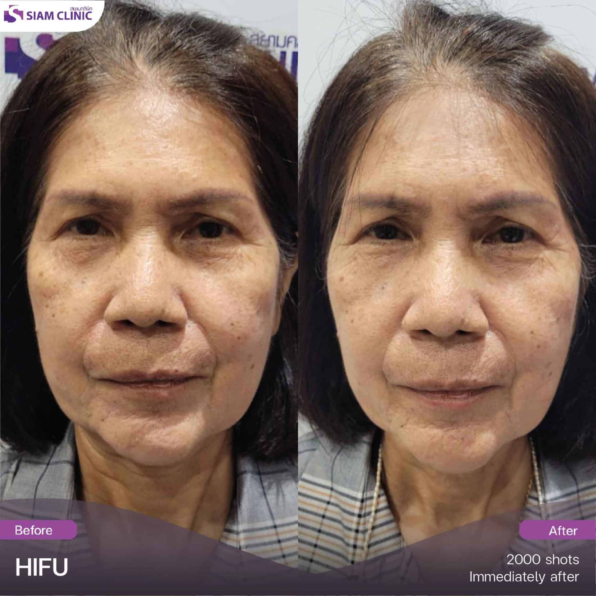 HIFU Case Review - Siam Clinic - Aesthetic & Wellness Clinic in Phuket