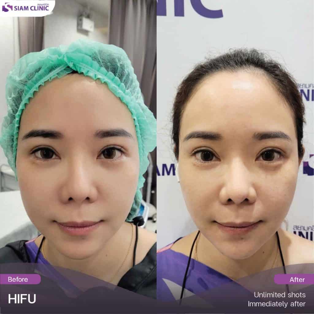 High-Intensity Focused Ultrasound (HIFU) in Phuket