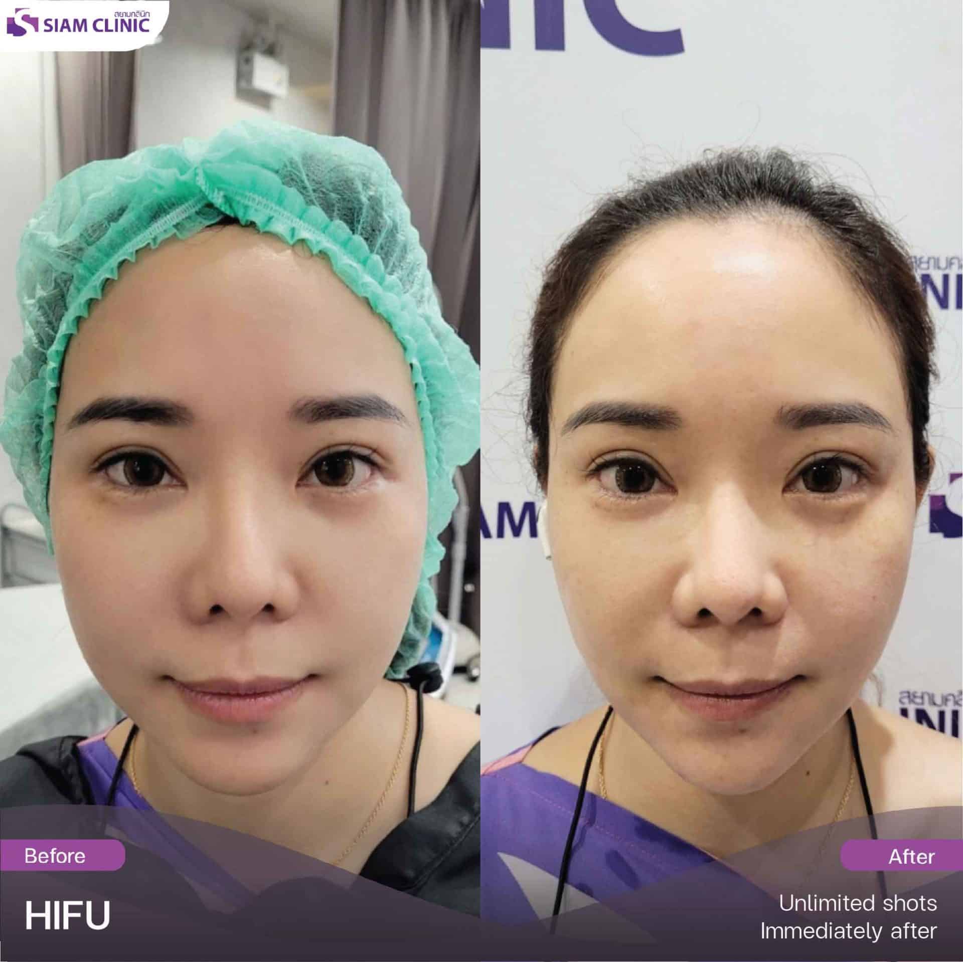 HIFU Case Review - Siam Clinic - Aesthetic & Wellness Clinic in Phuket