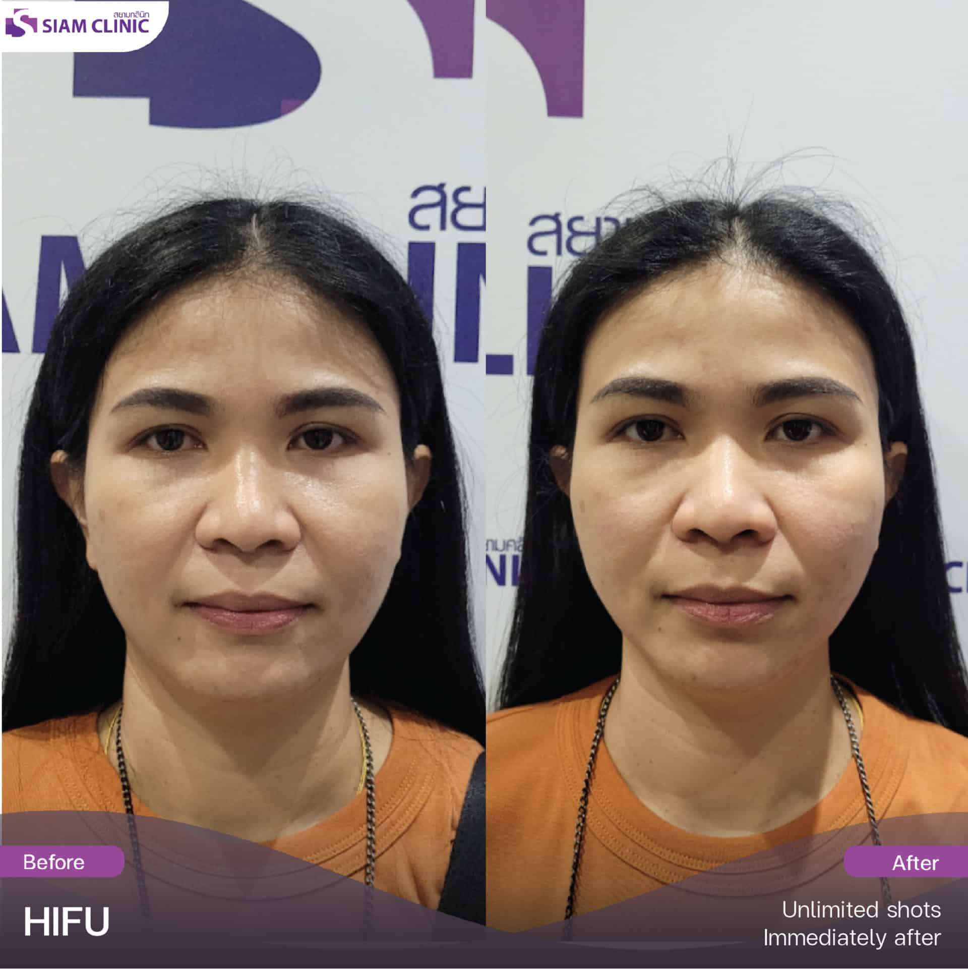 HIFU Case Review - Siam Clinic - Aesthetic & Wellness Clinic in Phuket