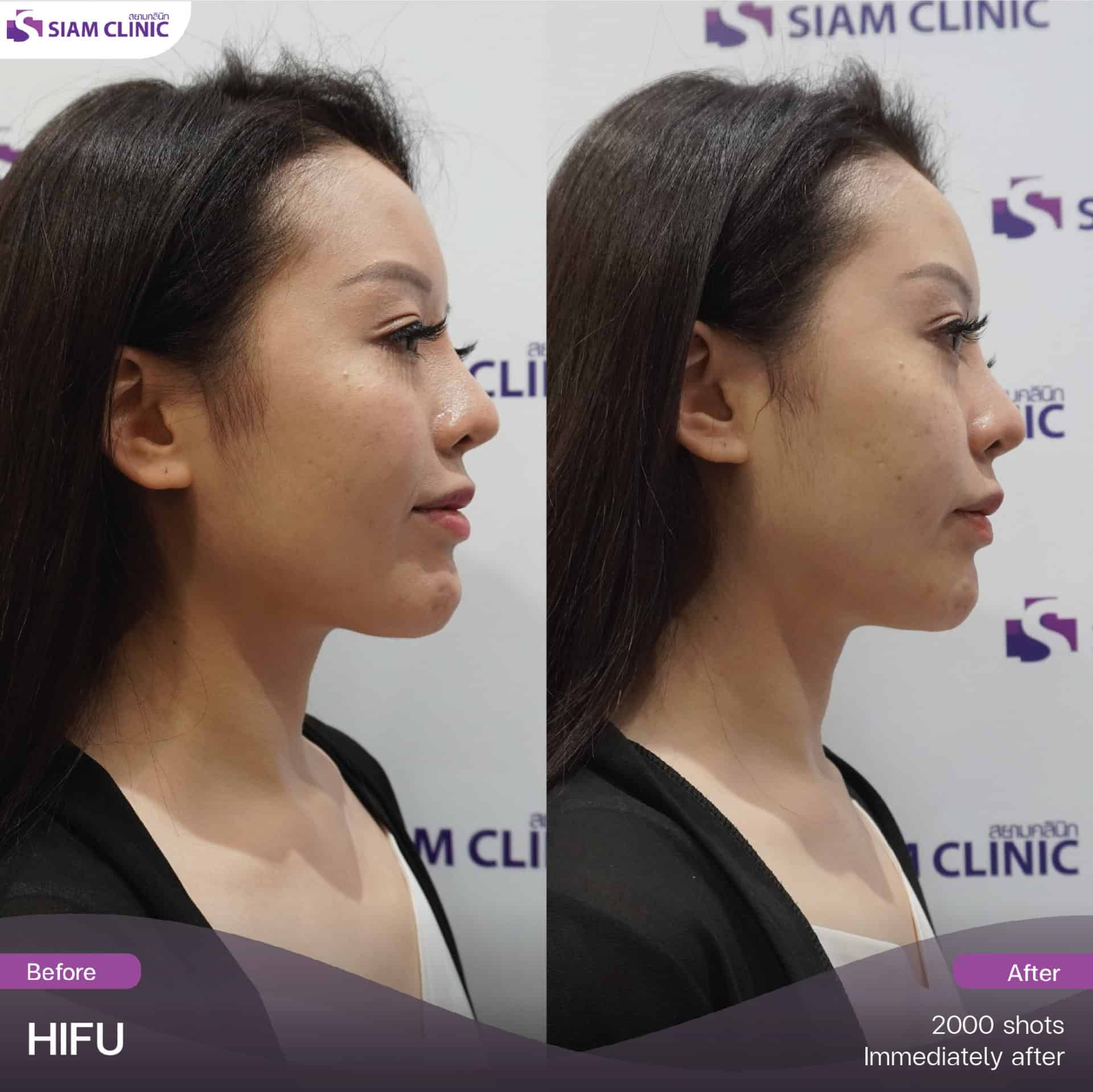 HIFU Case Review - Siam Clinic - Aesthetic & Wellness Clinic in Phuket