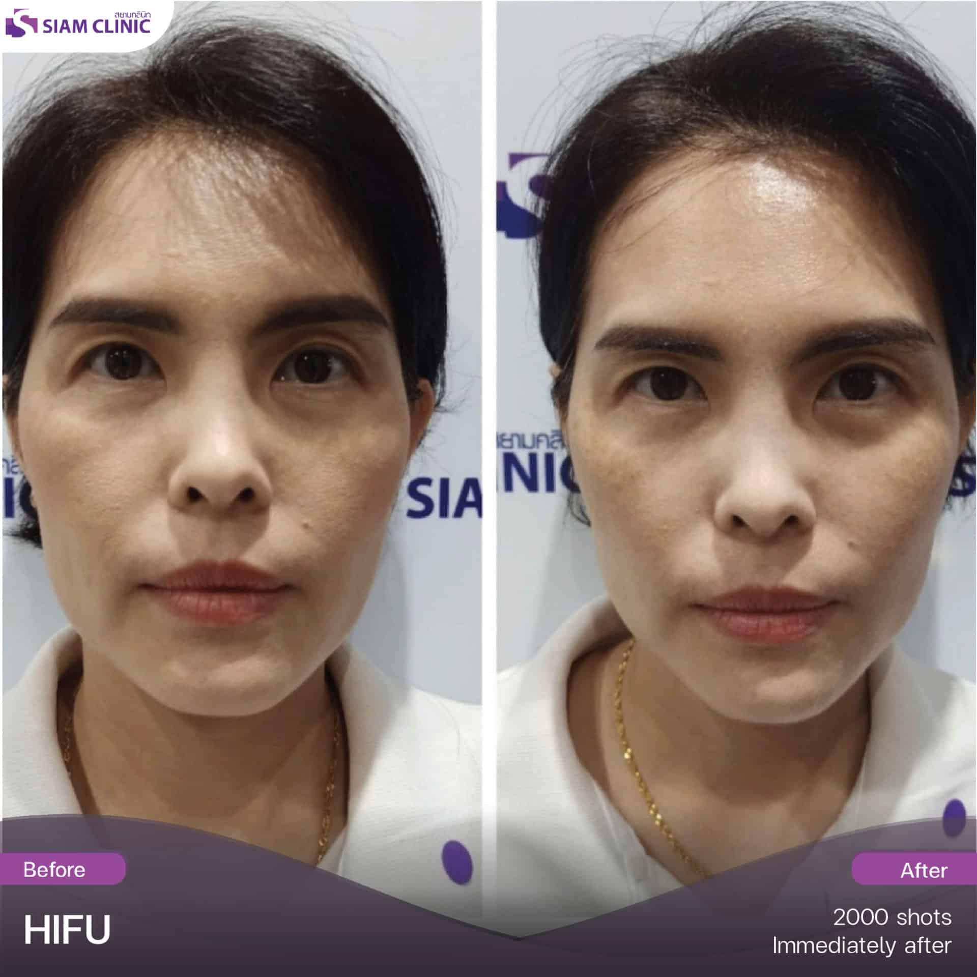HIFU Case Review - Siam Clinic - Aesthetic & Wellness Clinic in Phuket