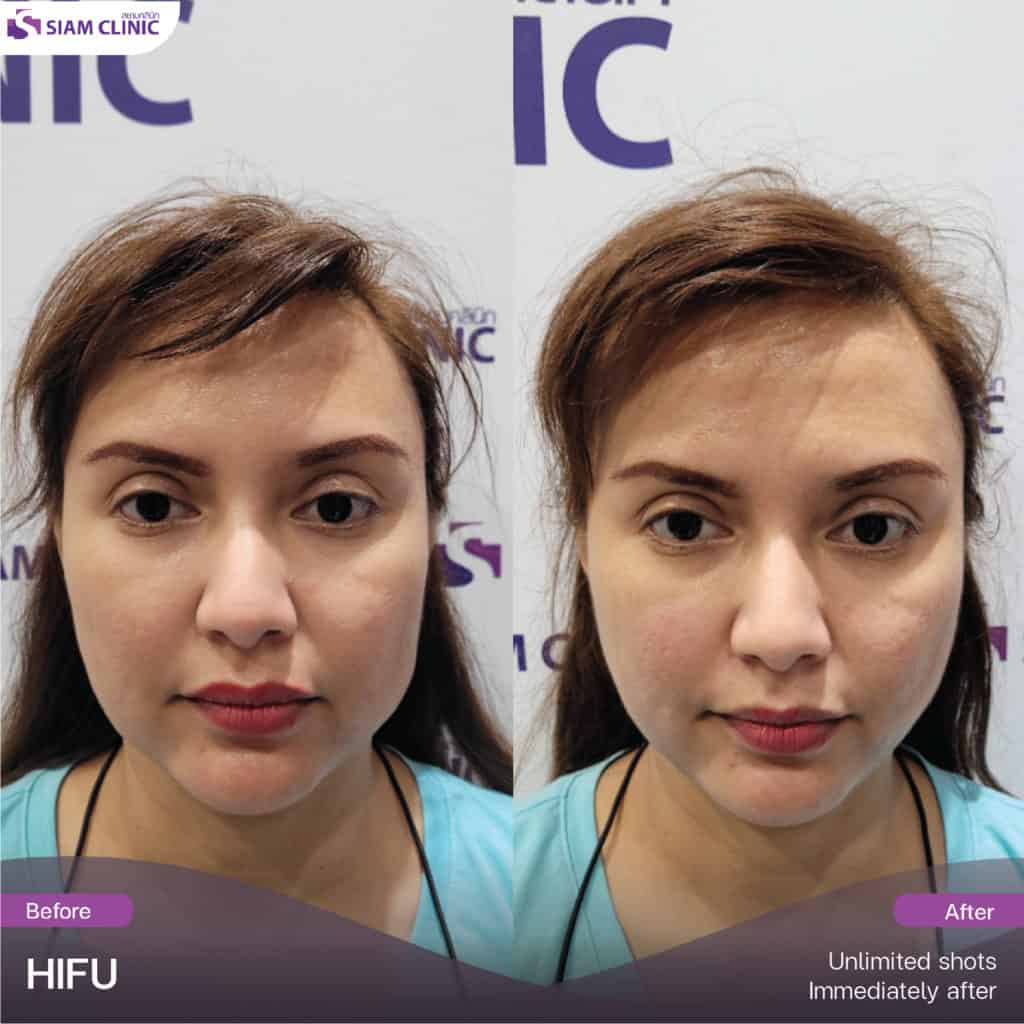 High-Intensity Focused Ultrasound (HIFU) in Phuket