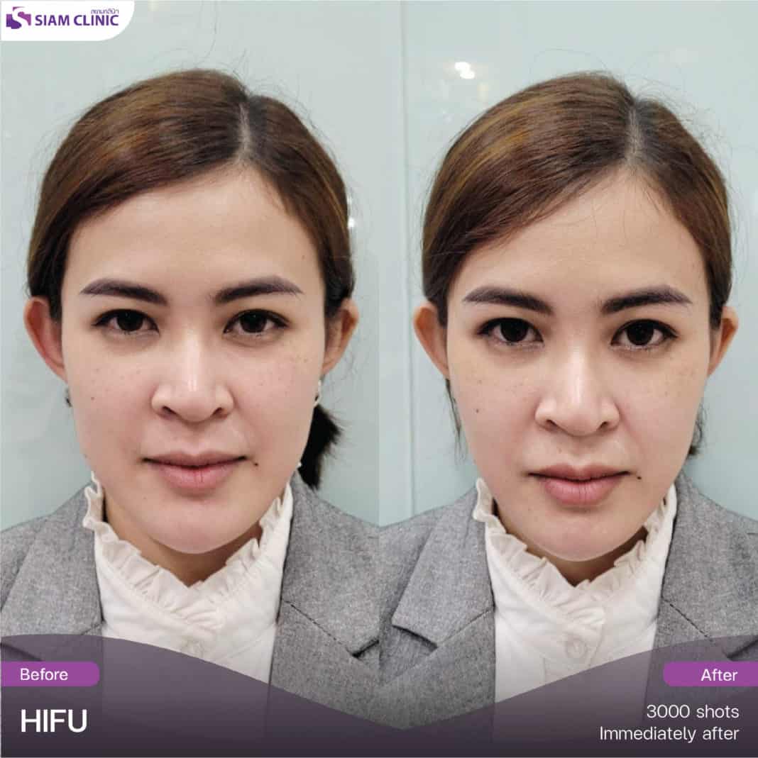 High-Intensity Focused Ultrasound (HIFU) in Phuket