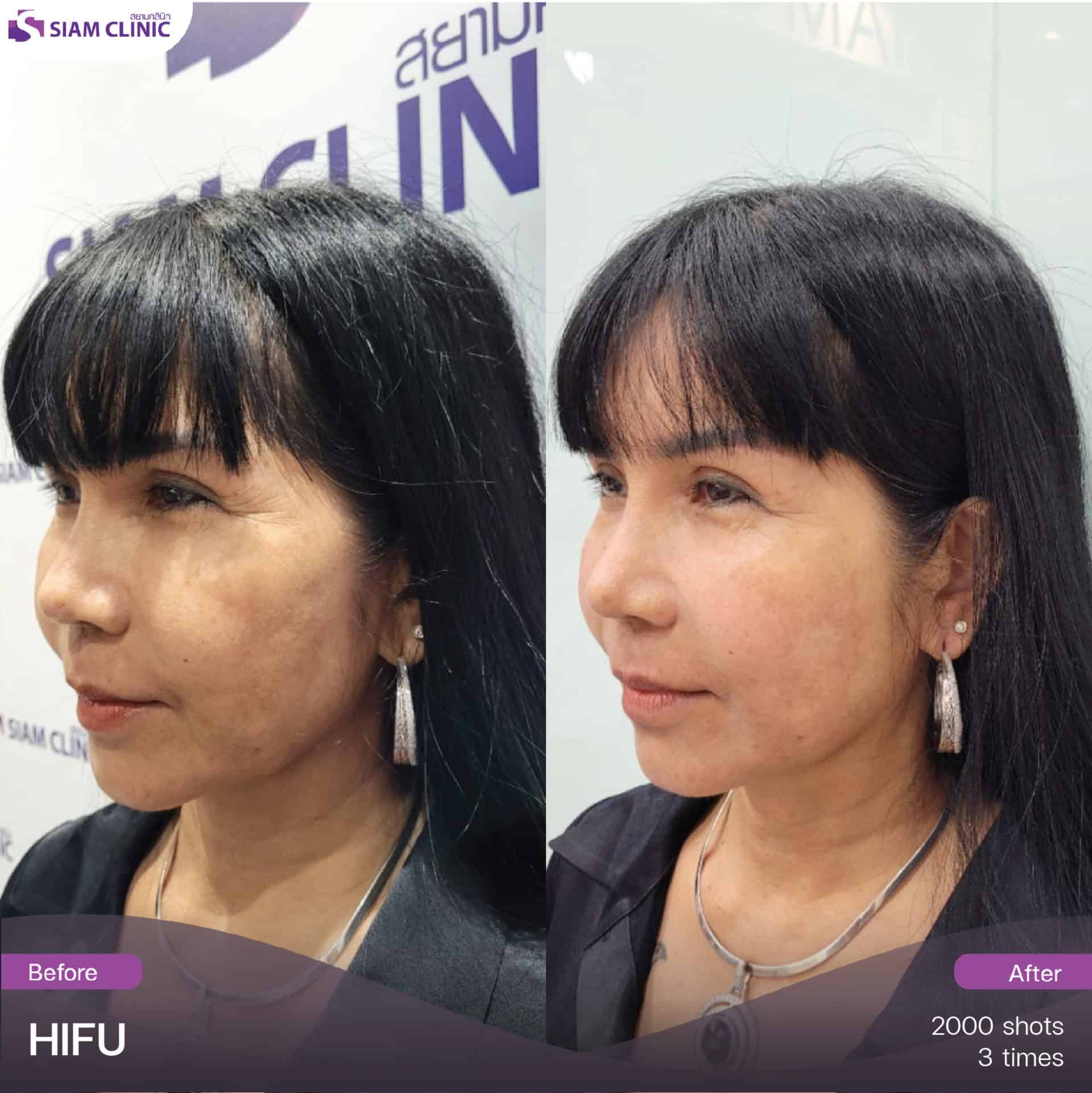 High-Intensity Focused Ultrasound (HIFU) in Phuket