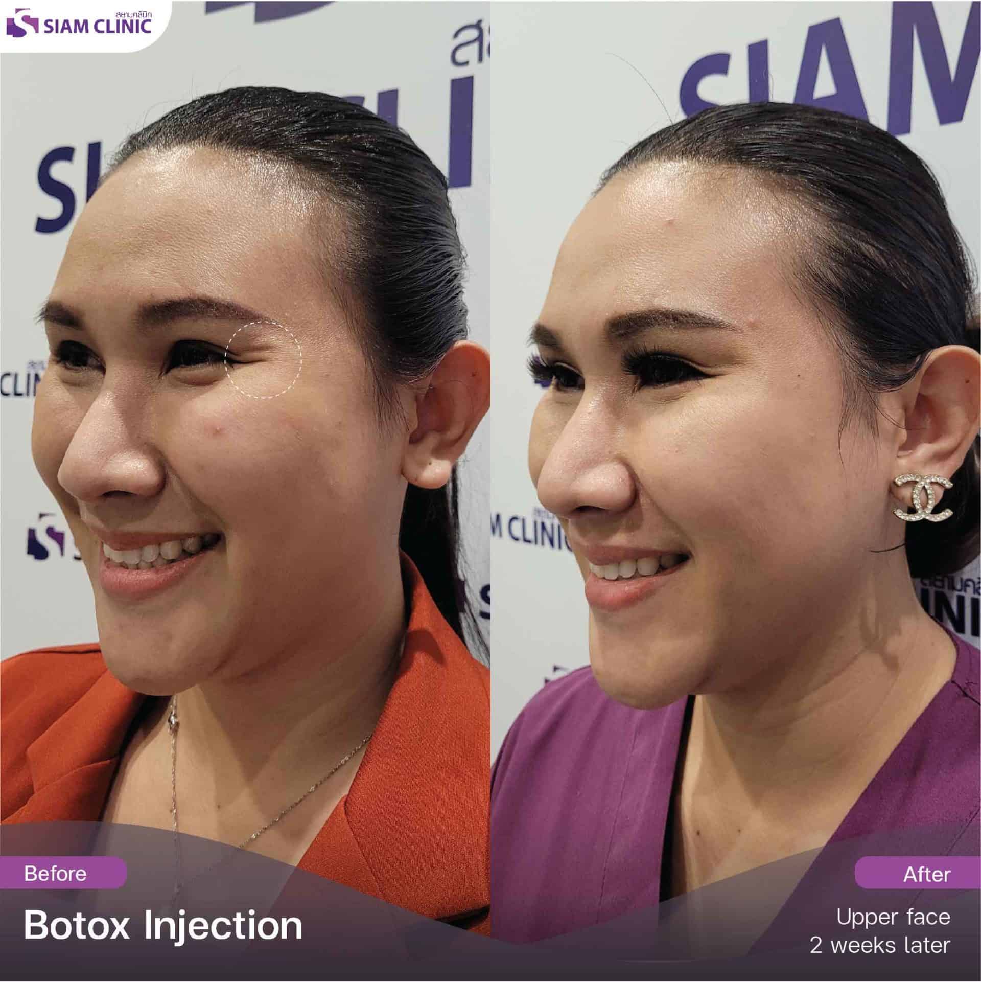 Botox Injection Case Review - Siam Clinic - Aesthetic & Wellness Clinic ...