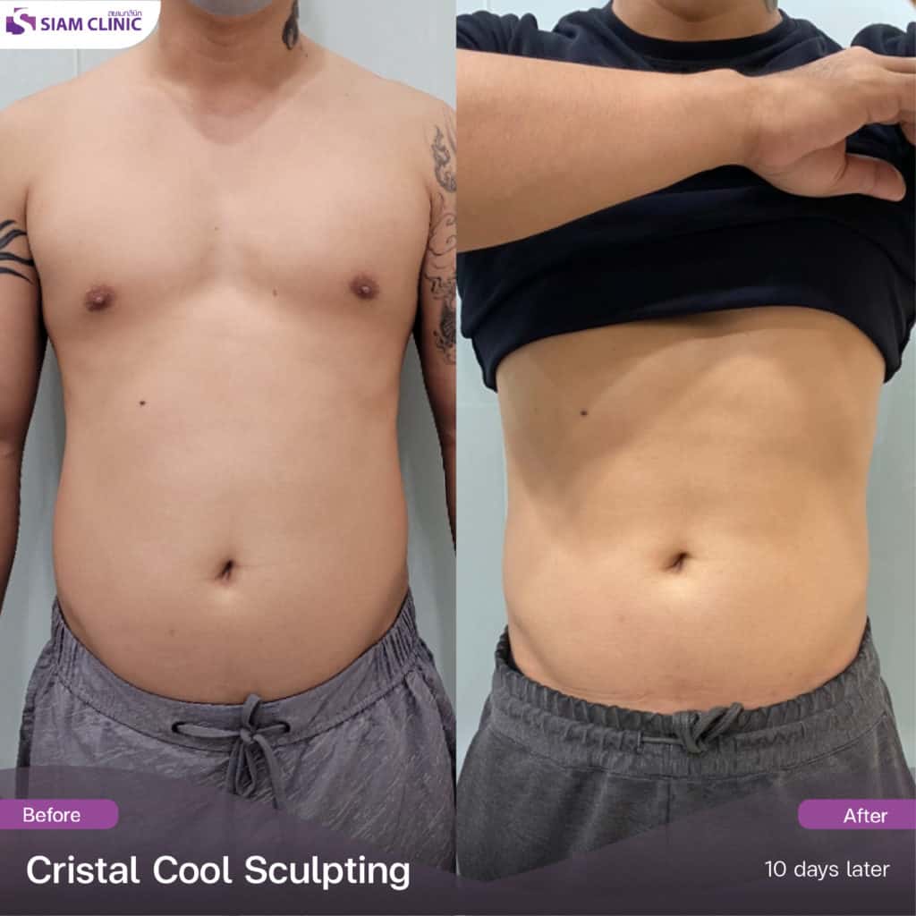 Cryolipolysis Fat Reduction (Coolsculping) - Siam Clinic Phuket