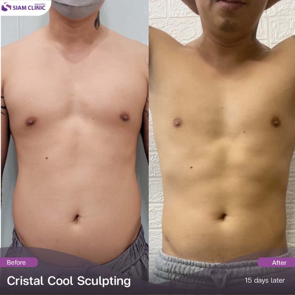 Cryolipolysis Fat Reduction (Coolsculping) - Siam Clinic Phuket