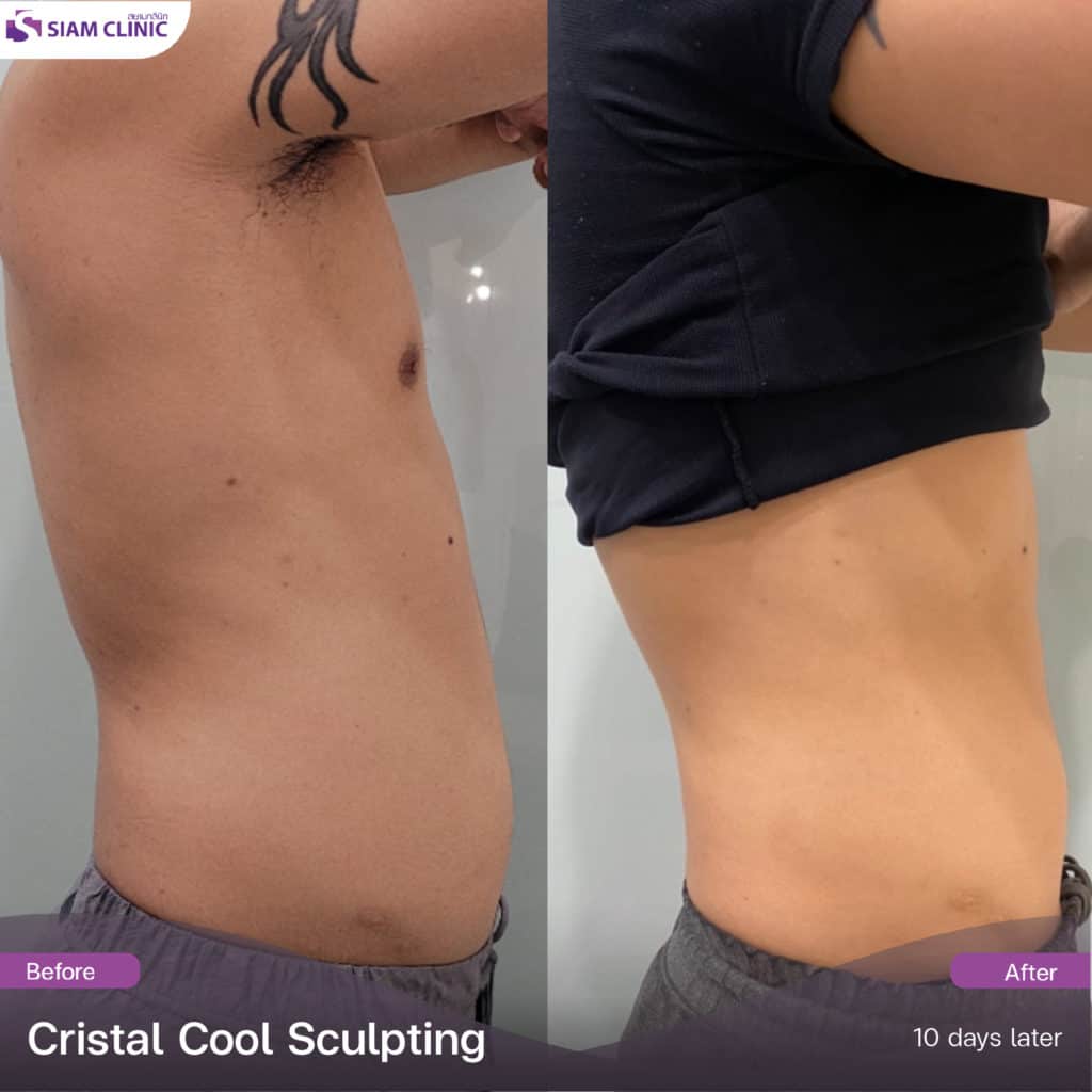 Cryolipolysis Fat Reduction (Coolsculping) - Siam Clinic Phuket