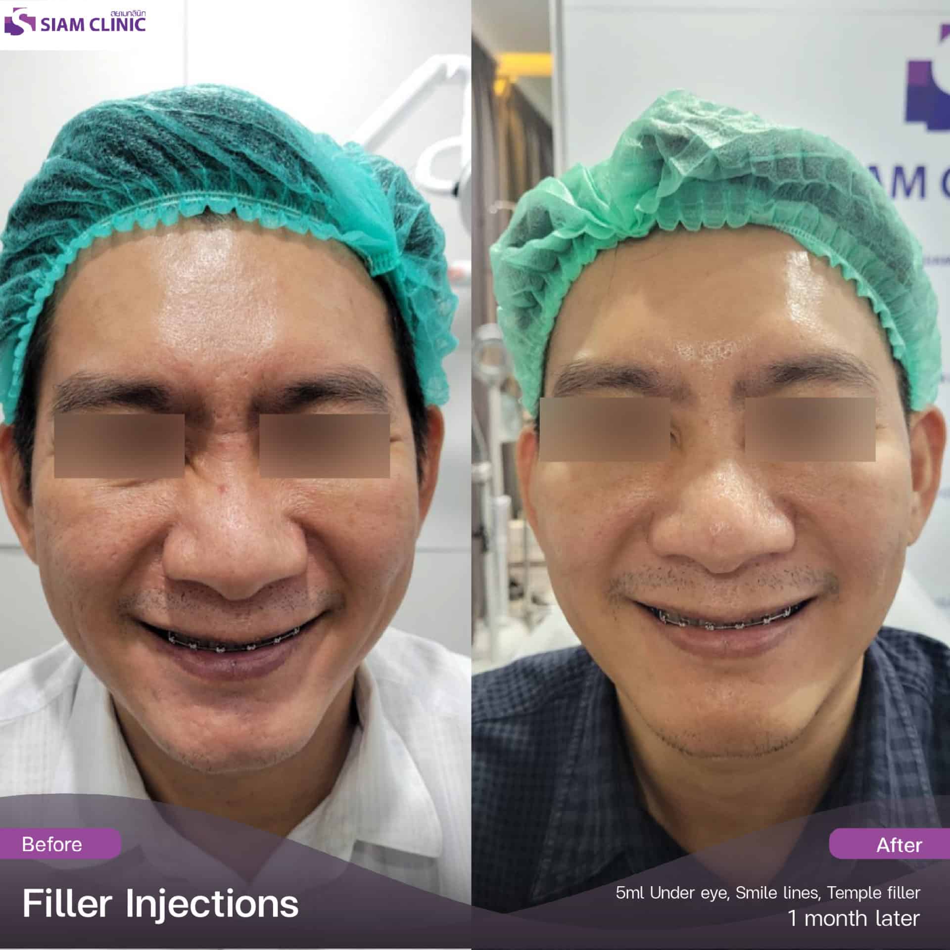 Dermal Filler Injection Case Review - Siam Clinic - Aesthetic ...