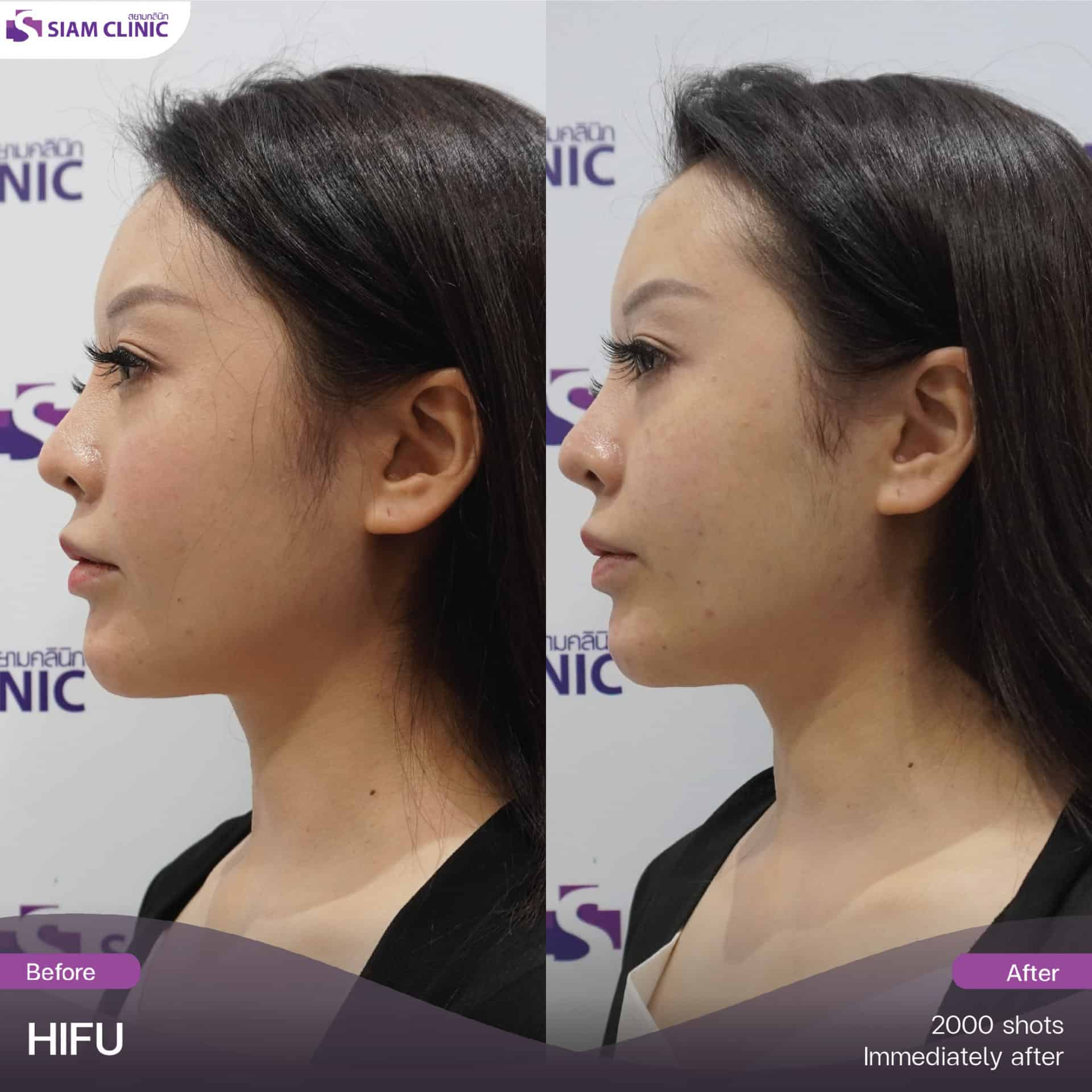 HIFU Case Review - Siam Clinic - Aesthetic & Wellness Clinic in Phuket