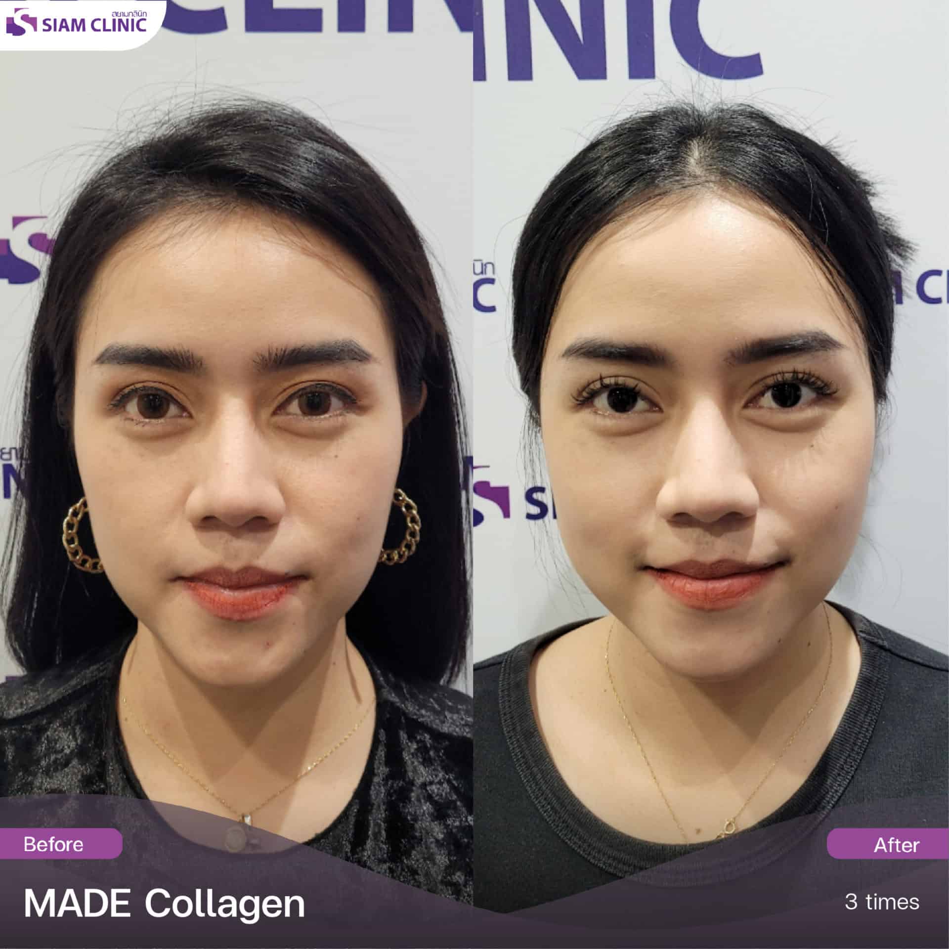 MADE Collagen - Siam Clinic - Aesthetic & Wellness Clinic in Phuket