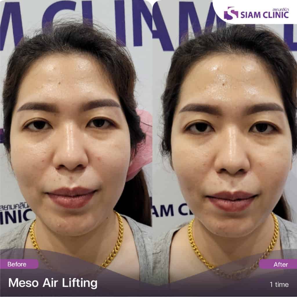 Facial treatment review - Siam Clinic - Aesthetic Clinic in Phuket