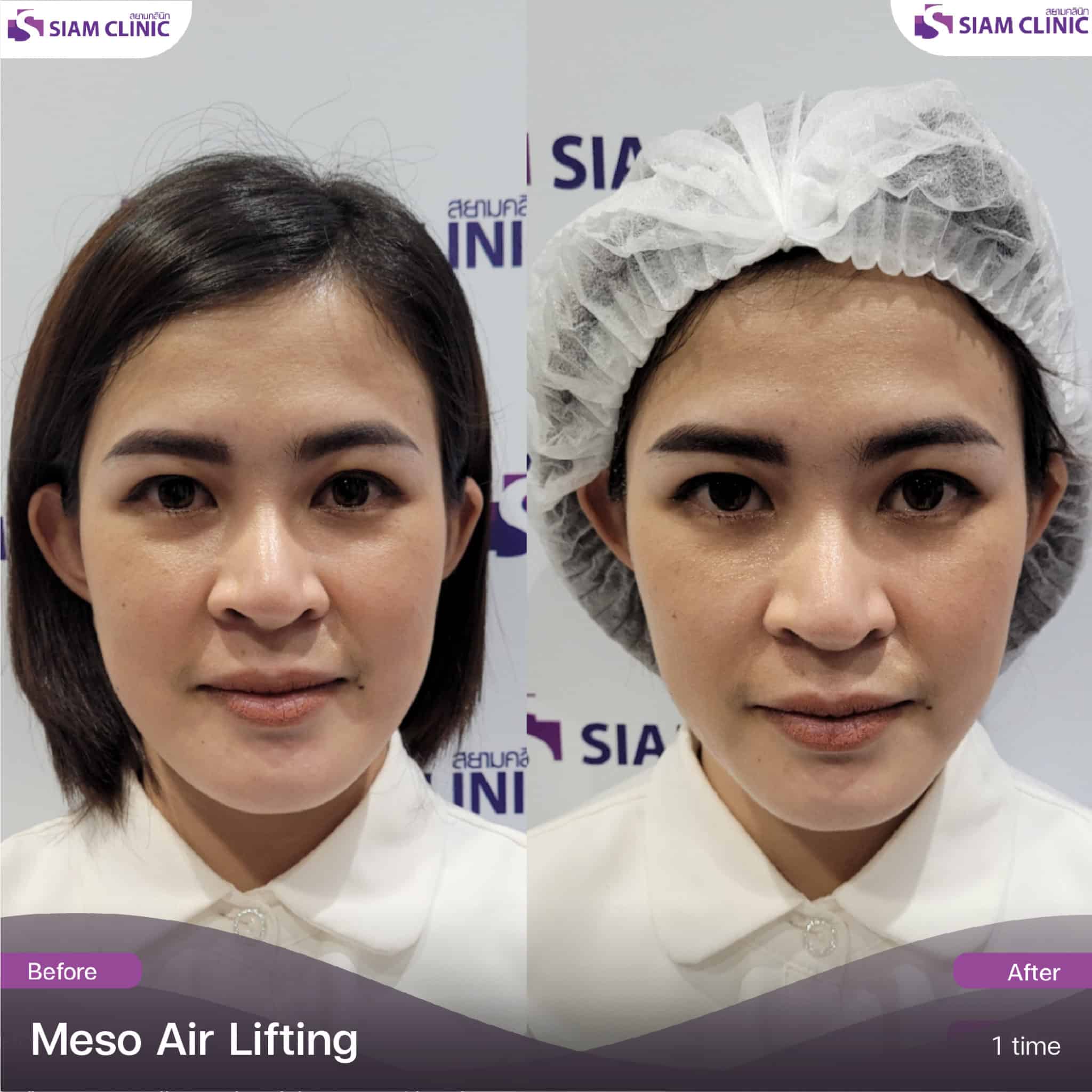 Facial treatment review รีวิว - Siam Clinic Phuket คลินิกความงามภูเก็ต