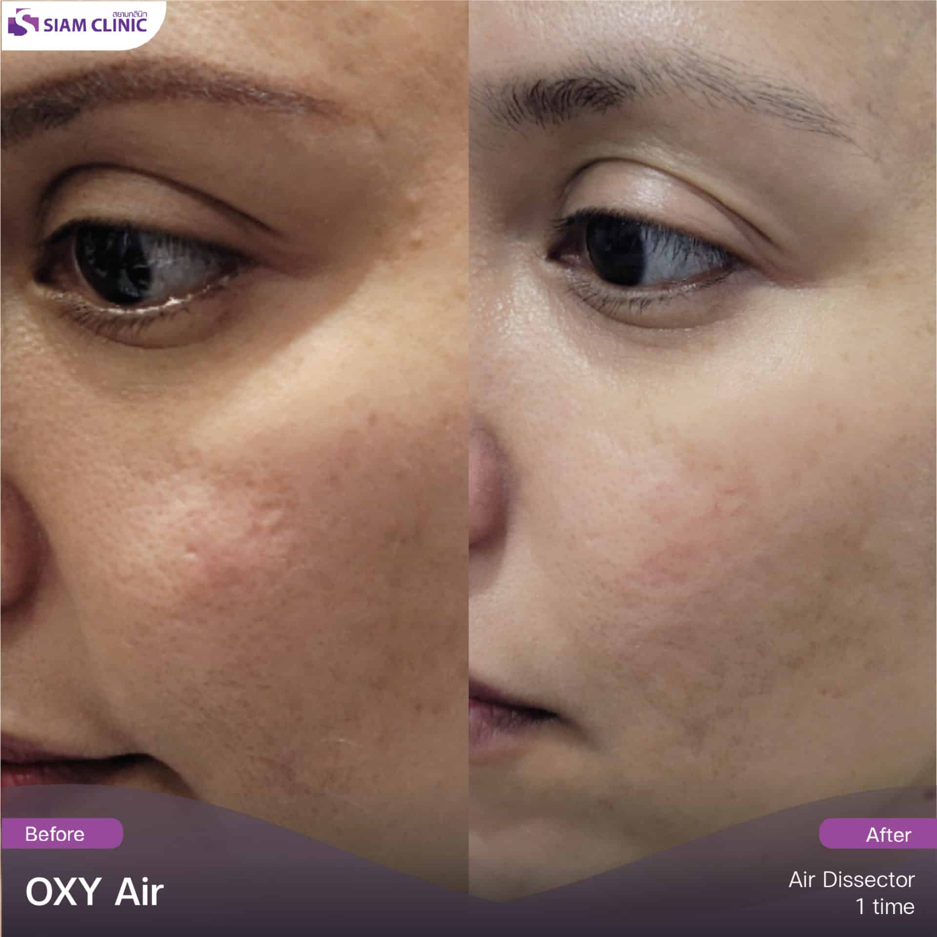 Oxy Air (Air Dessector) - Siam Clinic - Aesthetic & Wellness Clinic in ...