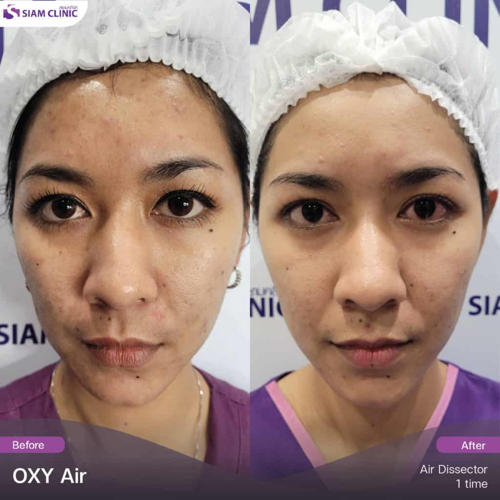 Oxy Air (Air Dessector) - Siam Clinic - Aesthetic & Wellness Clinic in ...