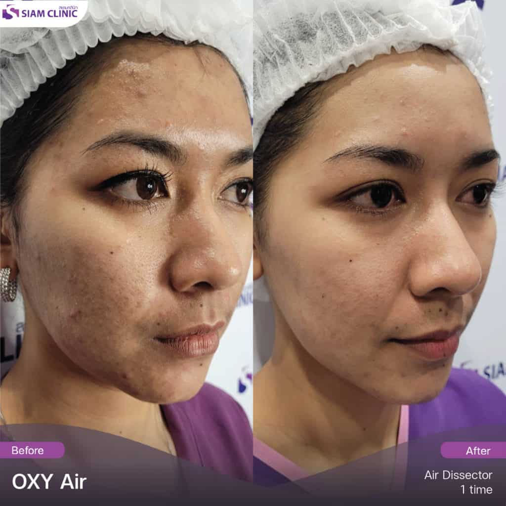 Oxy Air (Air Dessector) - Siam Clinic - Aesthetic & Wellness Clinic in ...