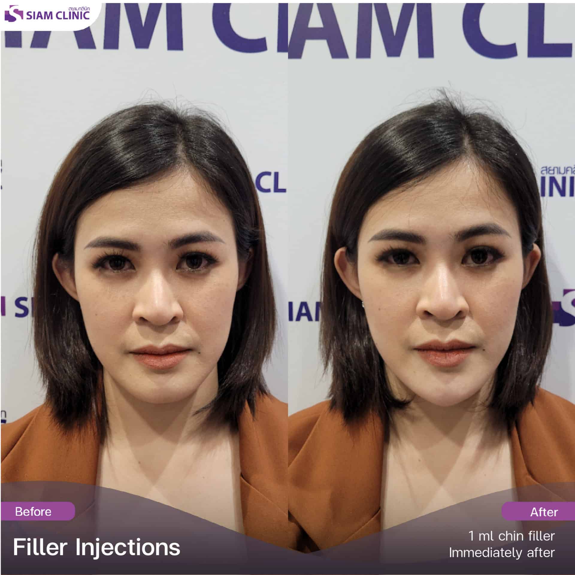 Chin and Jawline filler injection - Siam Clinic Phuket Aesthetic and ...