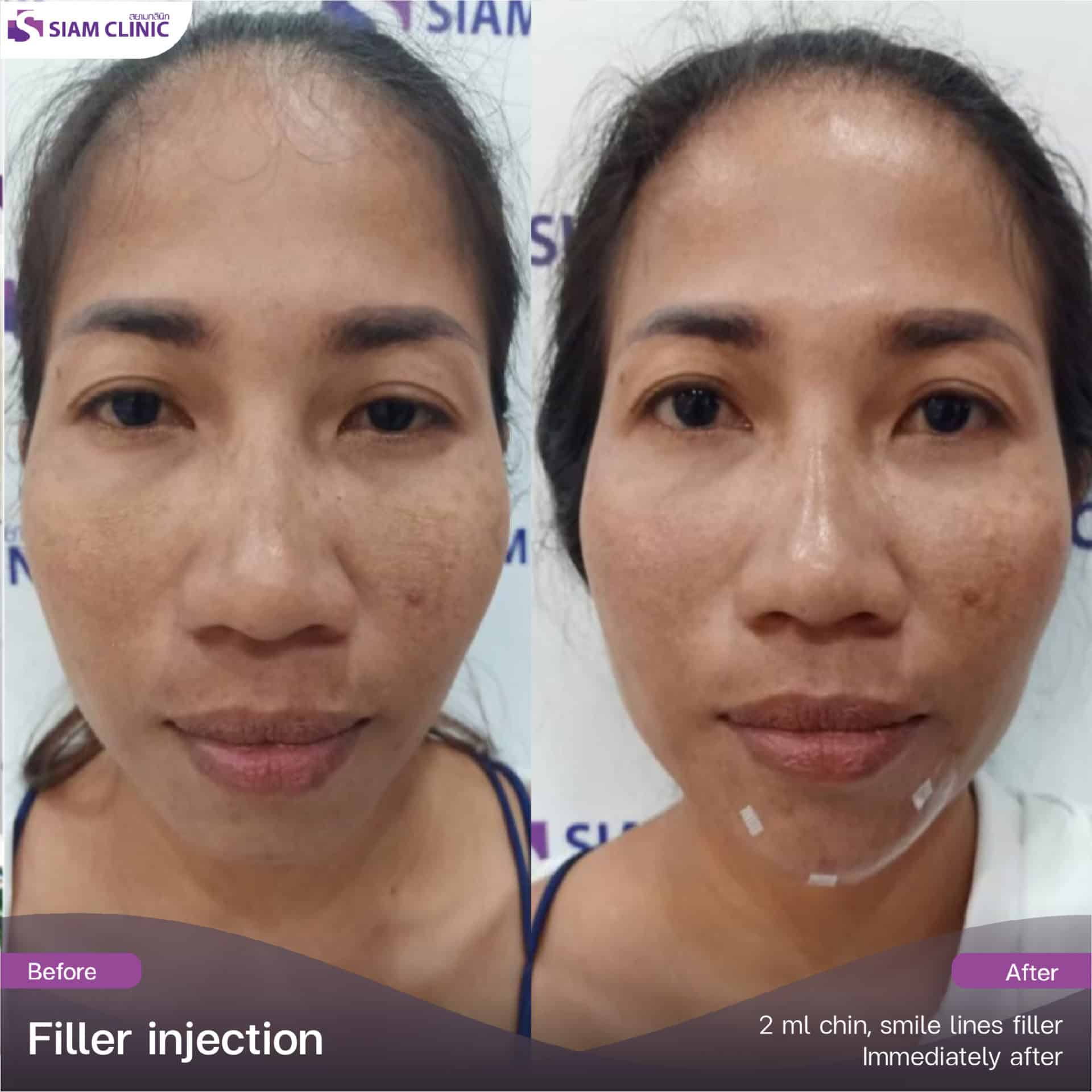 Dermal Filler Injection Case Review - Siam Clinic - Aesthetic ...