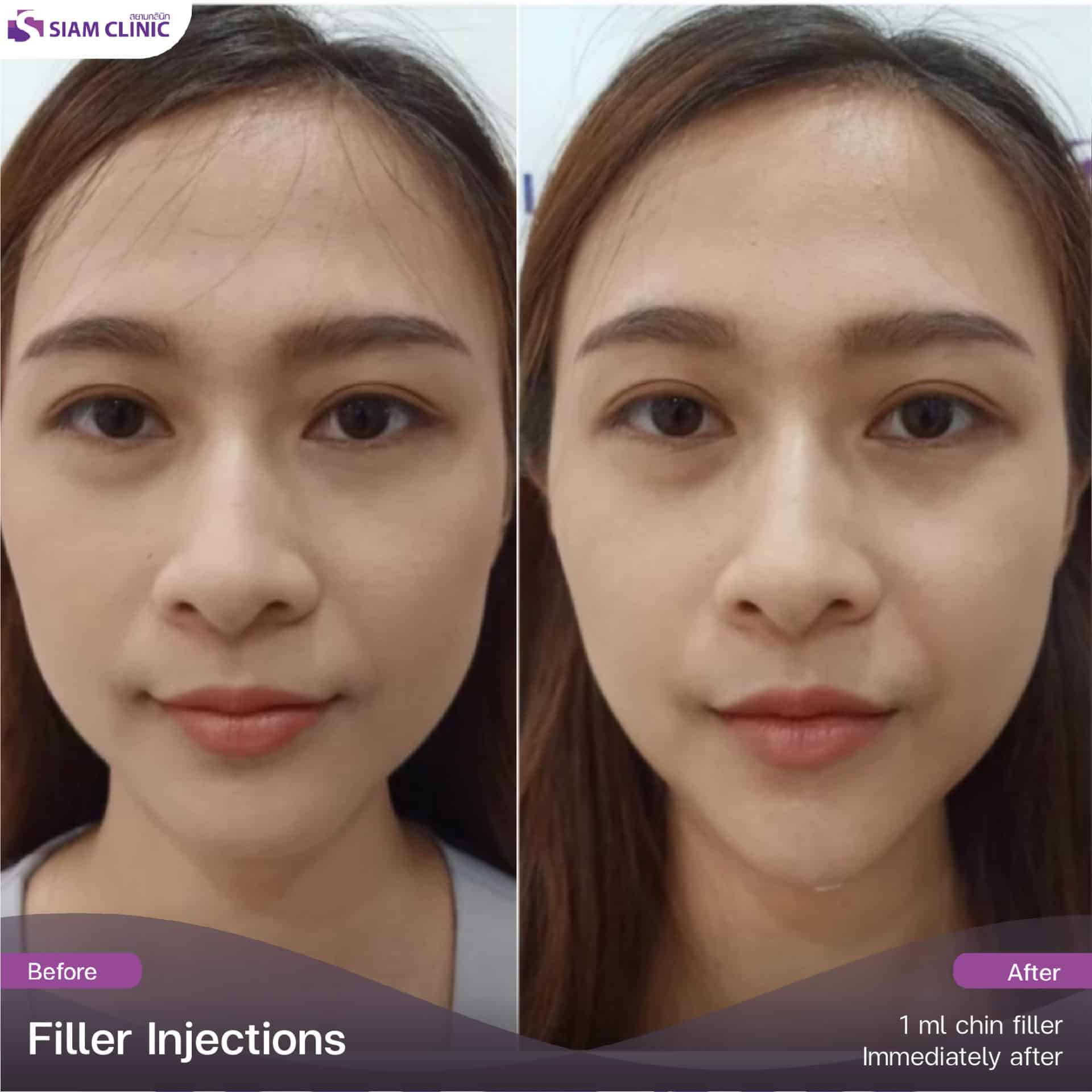 Chin and Jawline filler injection - Siam Clinic Phuket Aesthetic and ...