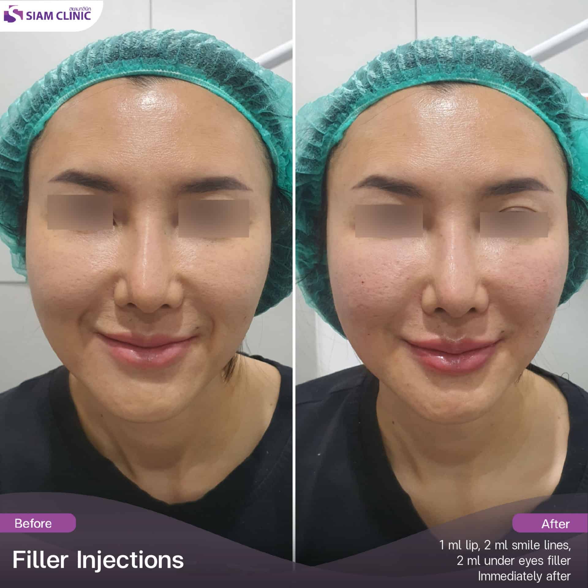 Nasolabial Line Filler - Siam Clinic - Aesthetic & Wellness Clinic in ...