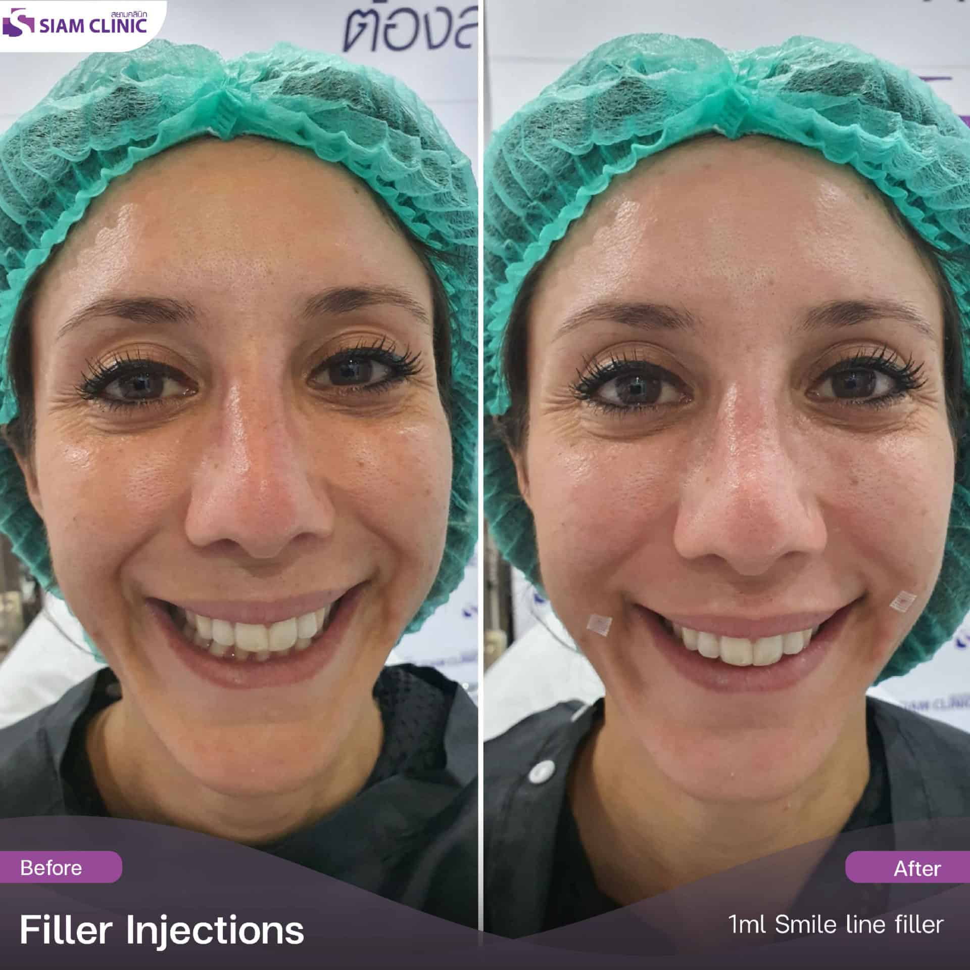 Nasolabial Line Filler - Siam Clinic - Aesthetic & Wellness Clinic in ...