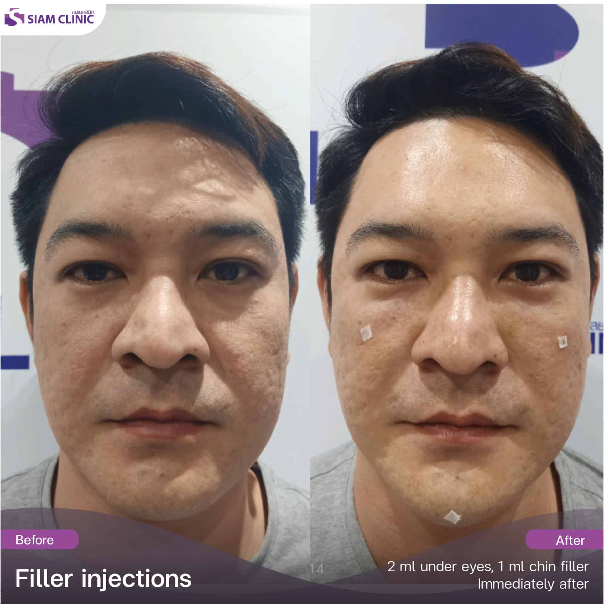 Chin and Jawline filler injection - Siam Clinic Phuket Aesthetic and ...