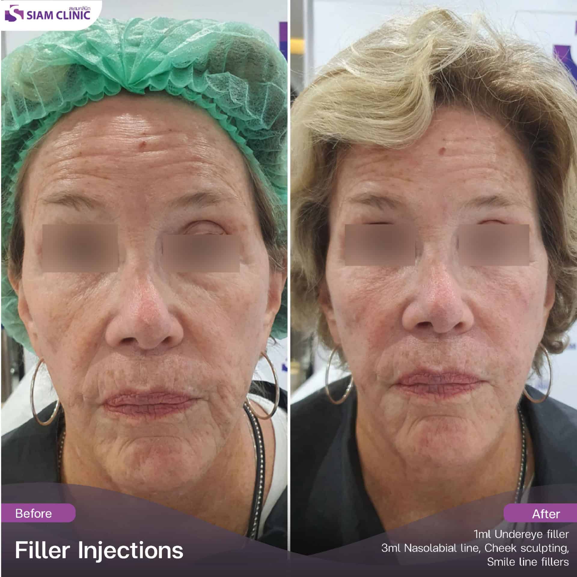 Nasolabial Line Filler - Siam Clinic - Aesthetic & Wellness Clinic in ...