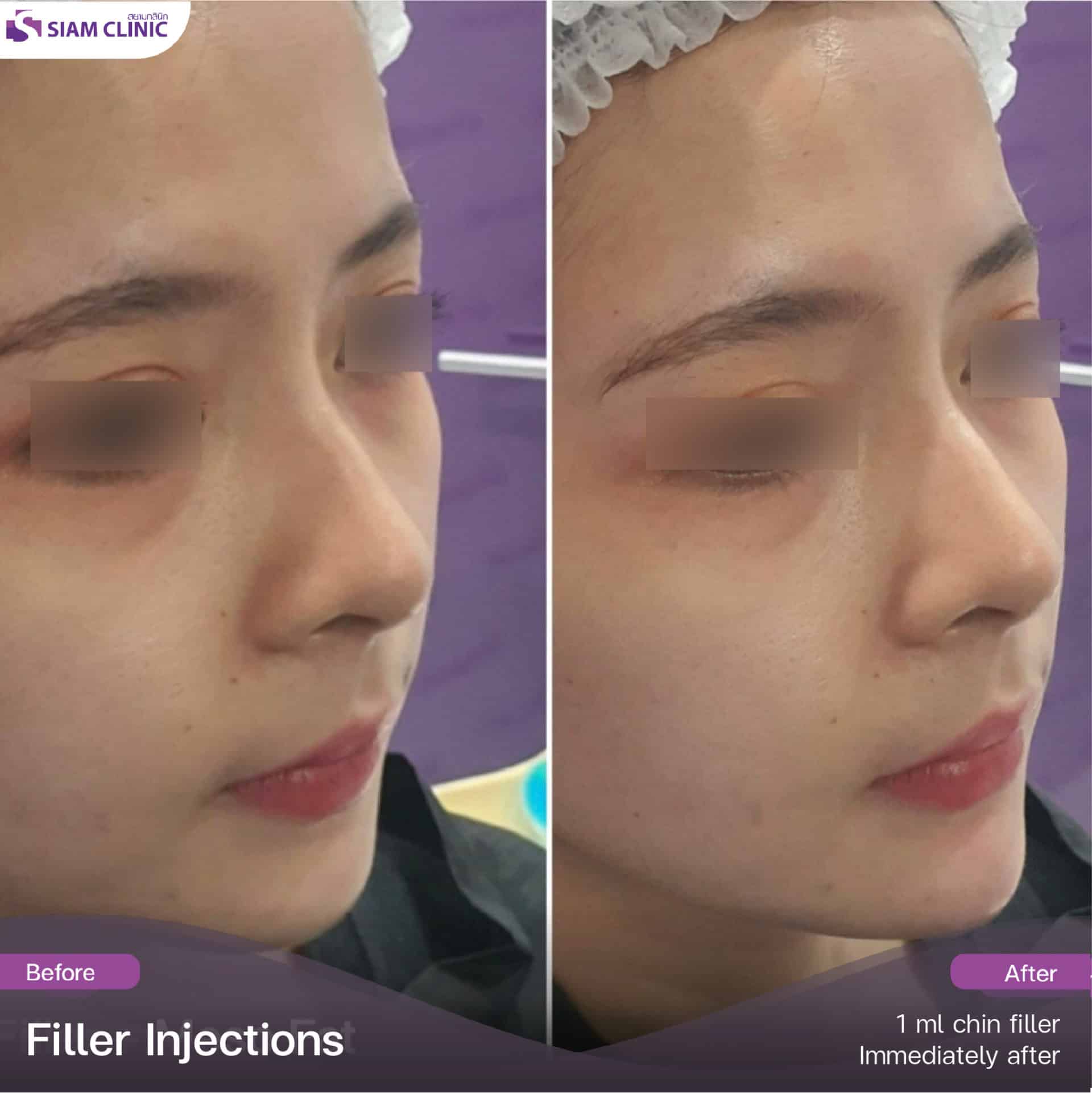 Chin and Jawline filler injection - Siam Clinic Phuket Aesthetic and ...
