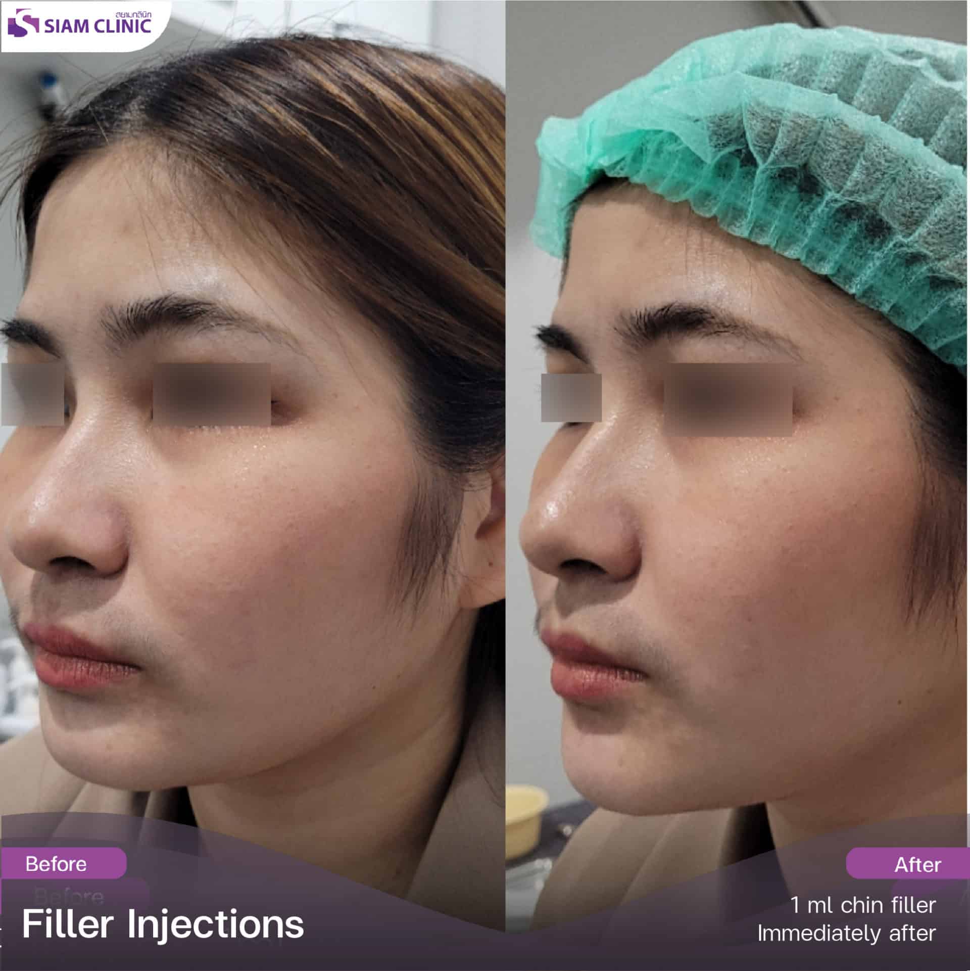 Chin and Jawline filler injection - Siam Clinic Phuket Aesthetic and ...