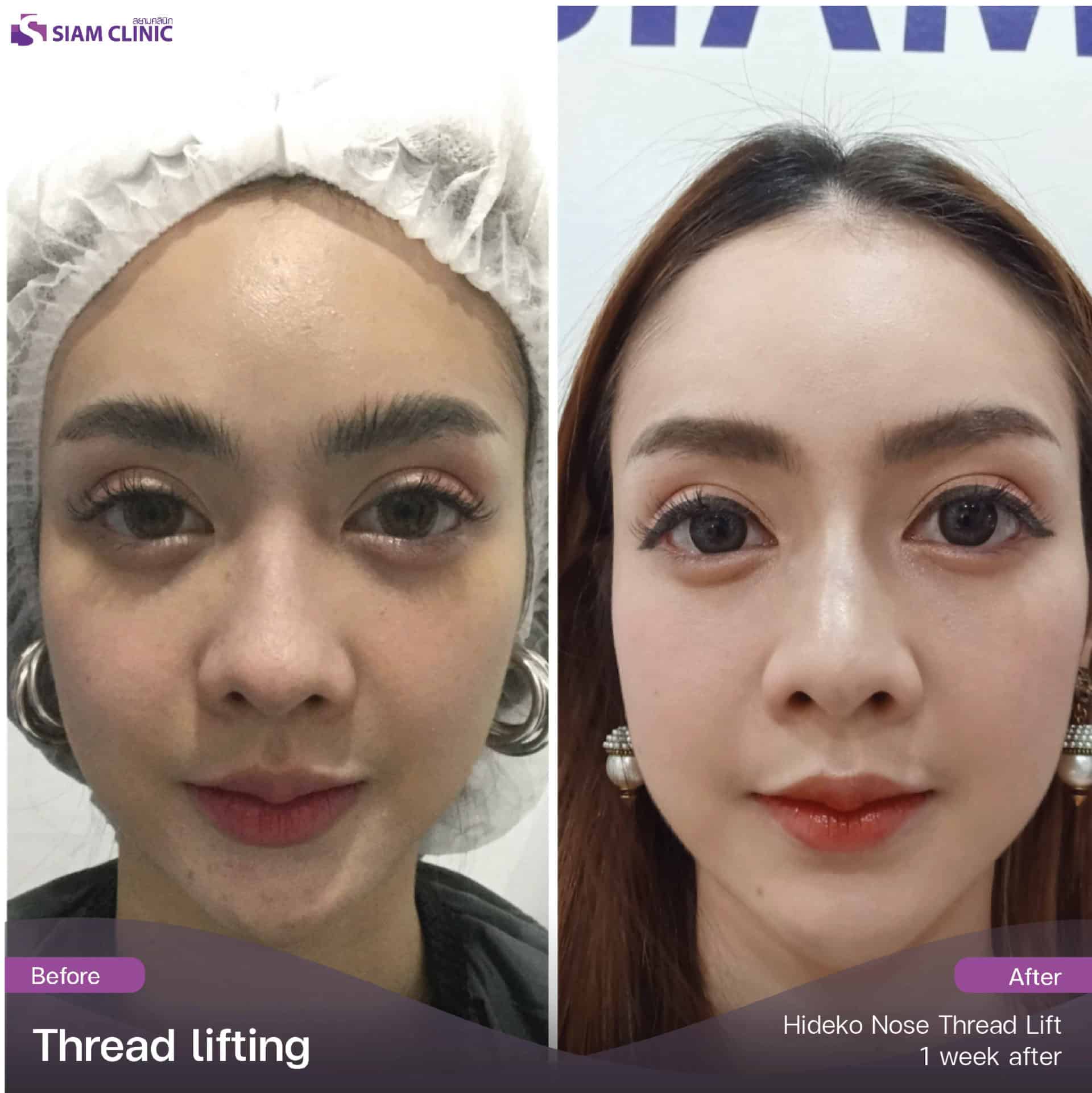 Nose Thread Lift - Siam Clinic - Aesthetic & Wellness Clinic in Phuket