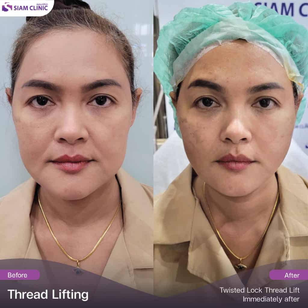 Thread Lifting Review - Siam Clinic - Aesthetic & Wellness Clinic in Phuket