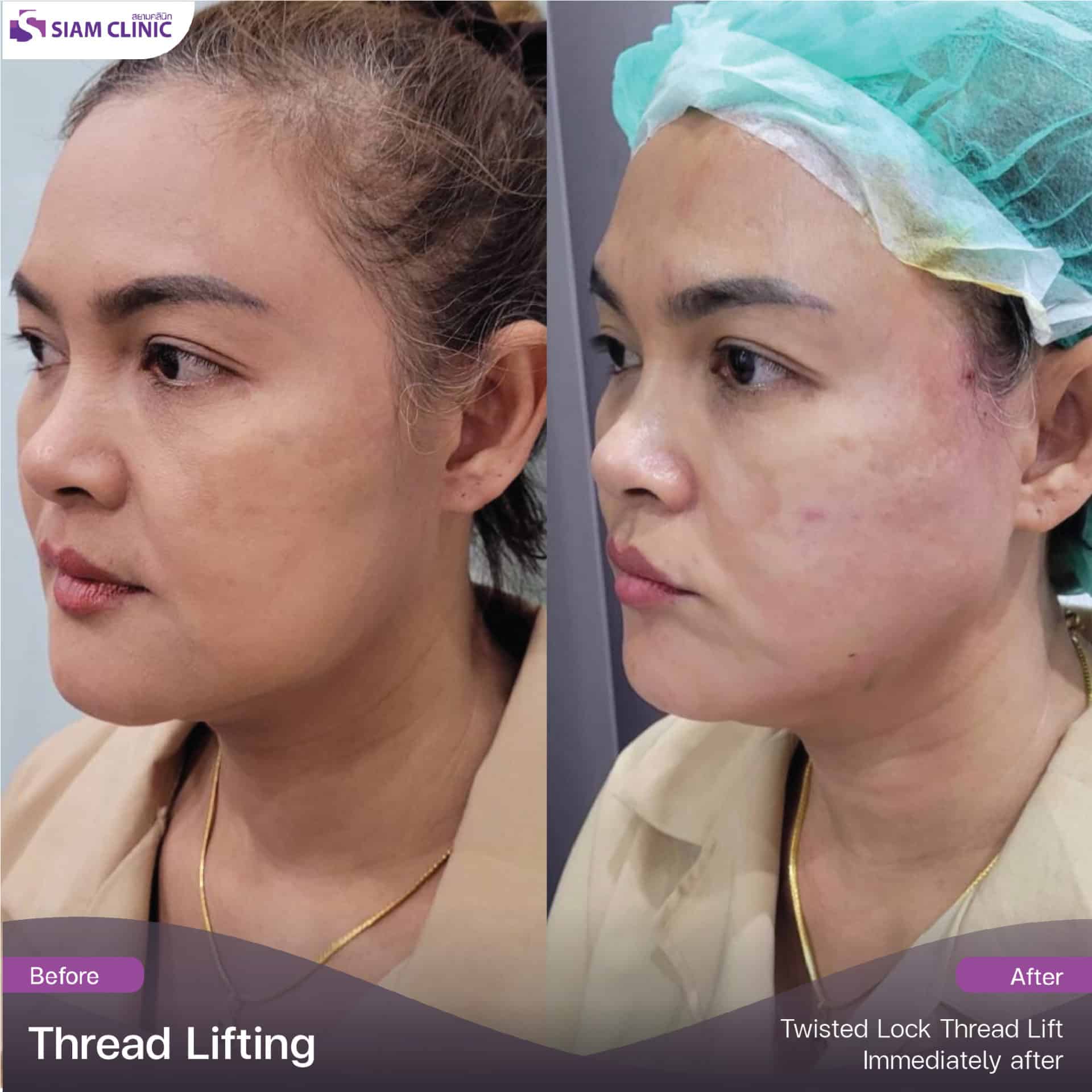 Thread Lifting Review - Siam Clinic - Aesthetic & Wellness Clinic in Phuket