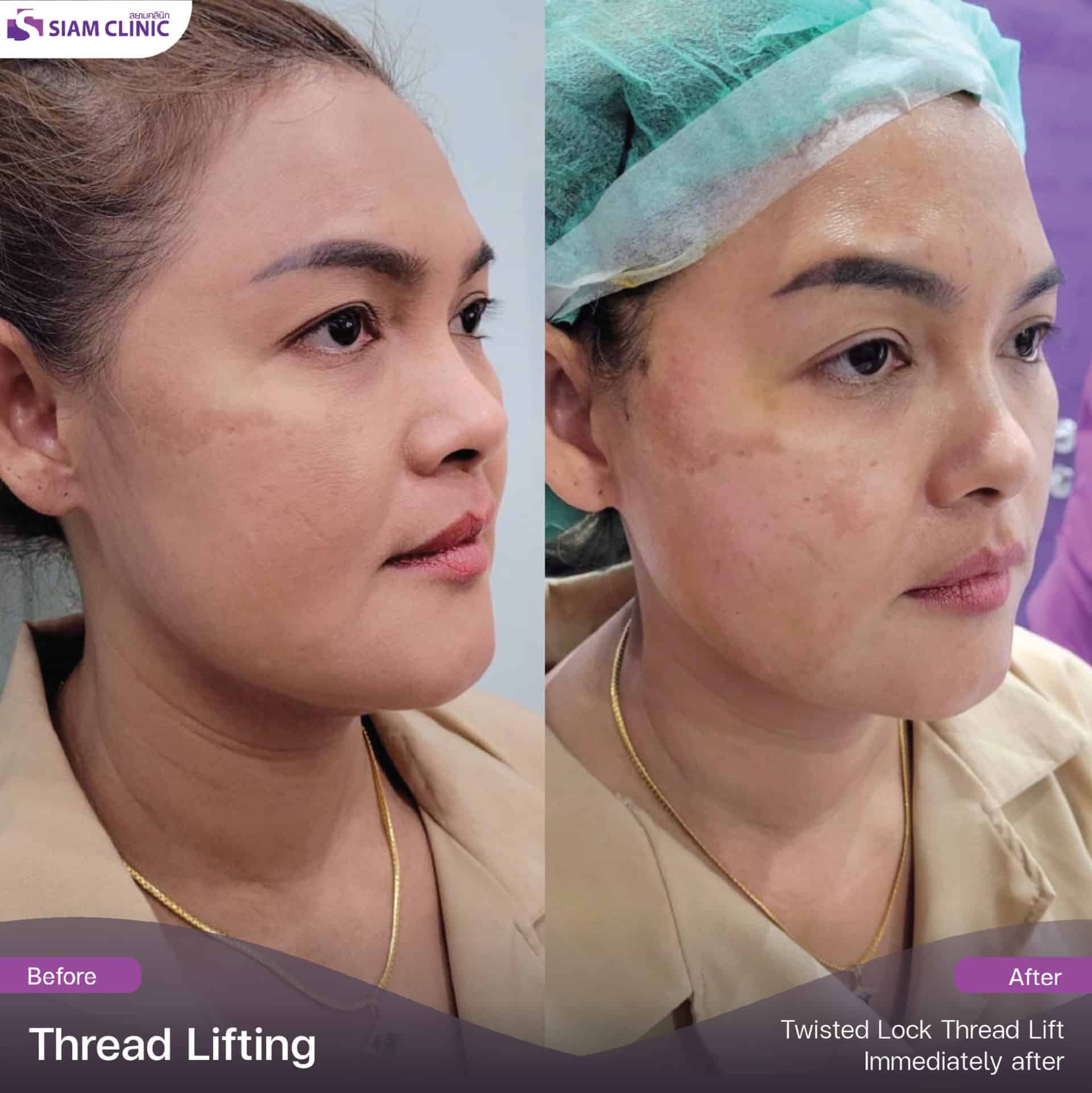 Jawline Thread lifting - Siam Clinic - Aesthetic & Wellness Clinic in ...
