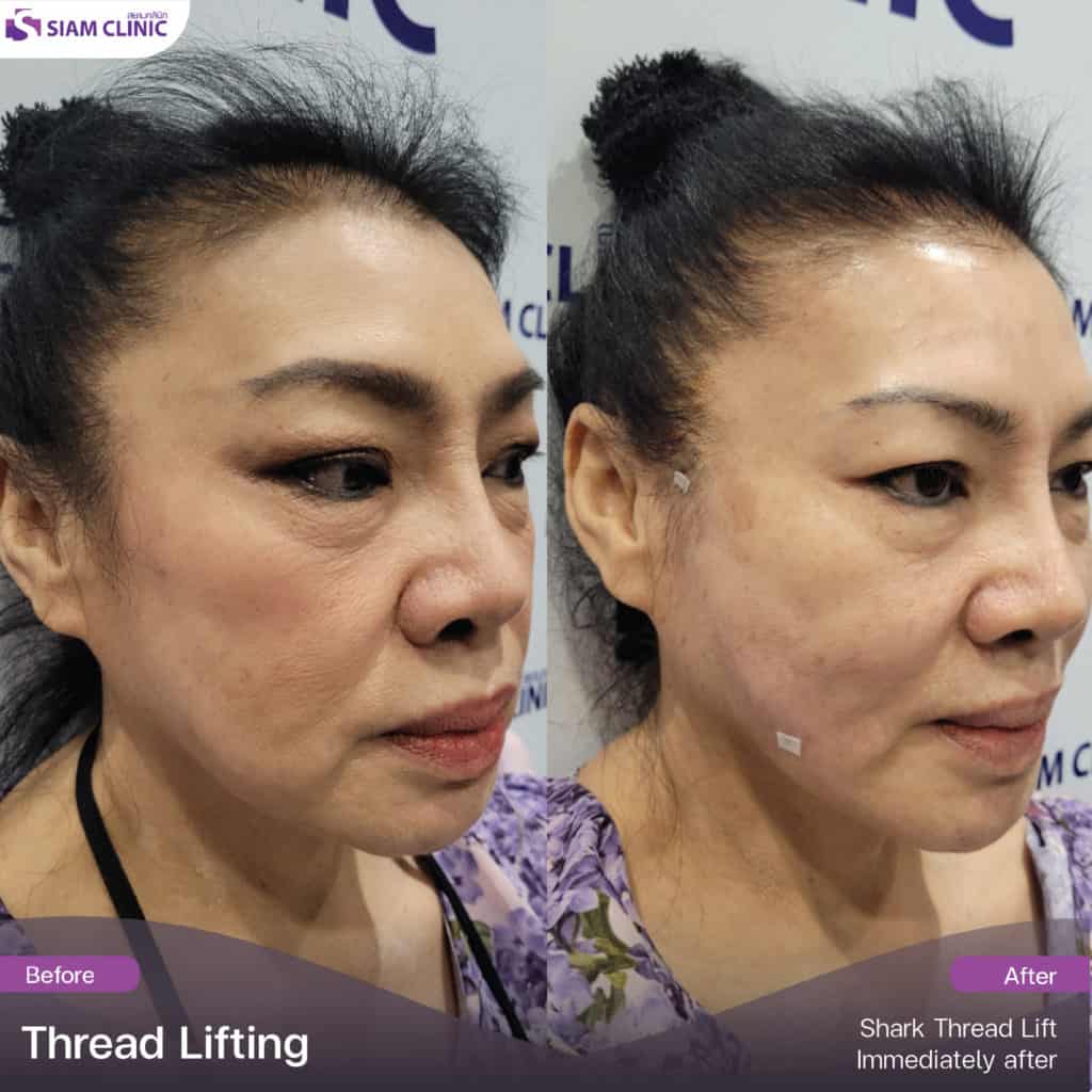 Thread Lifting Review - Siam Clinic - Aesthetic & Wellness Clinic in Phuket