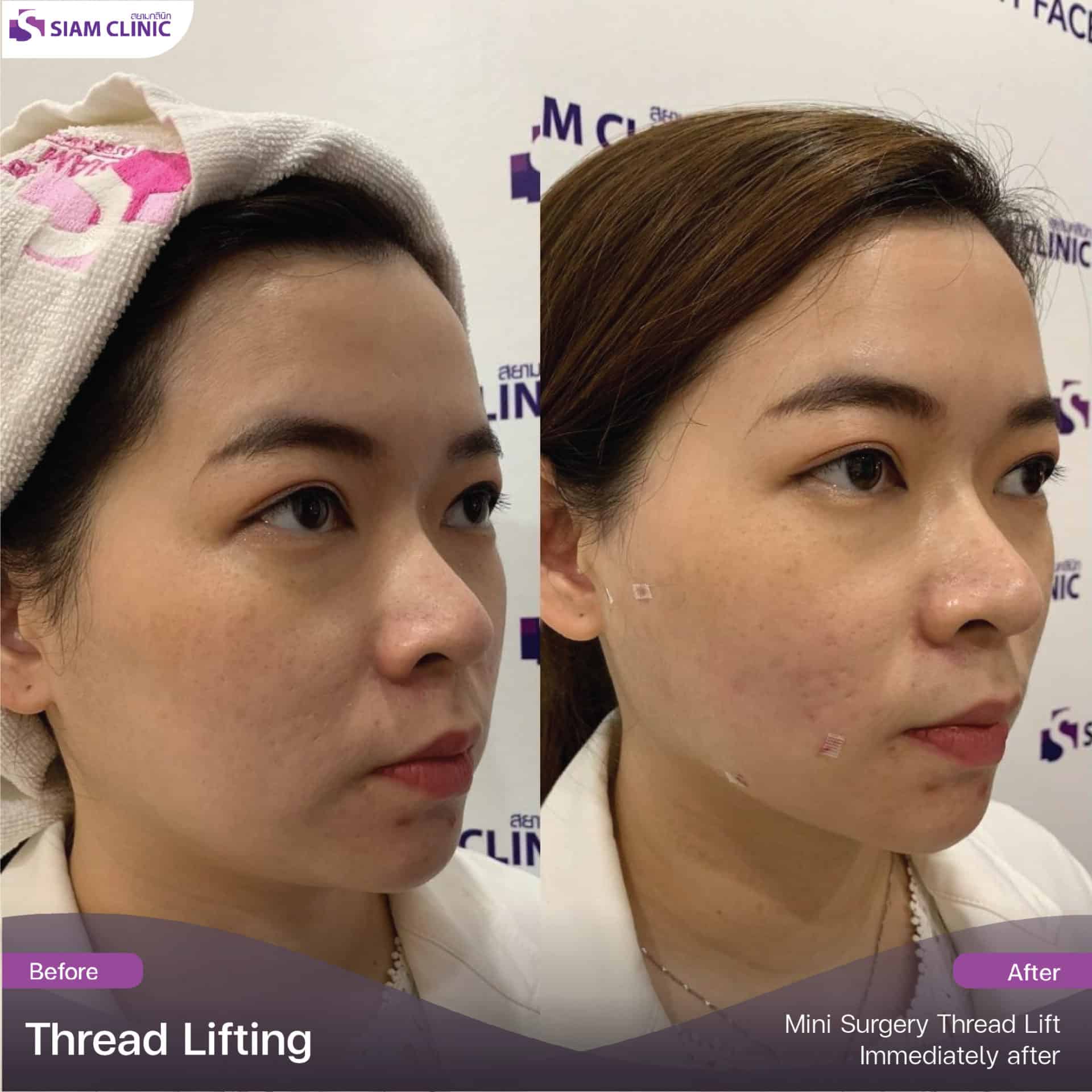 Jawline Thread lifting - Siam Clinic - Aesthetic & Wellness Clinic in ...