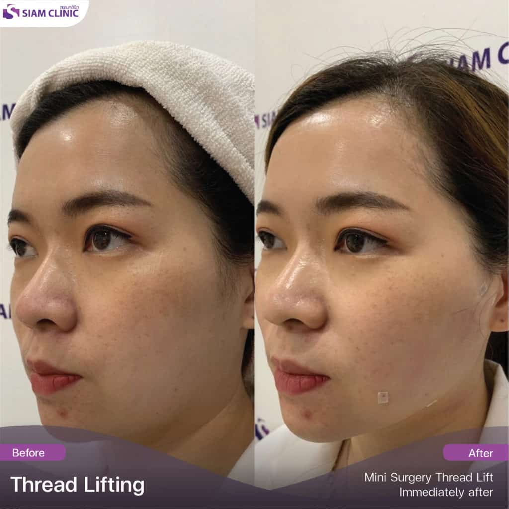 Jawline Thread lifting - Siam Clinic - Aesthetic & Wellness Clinic in ...