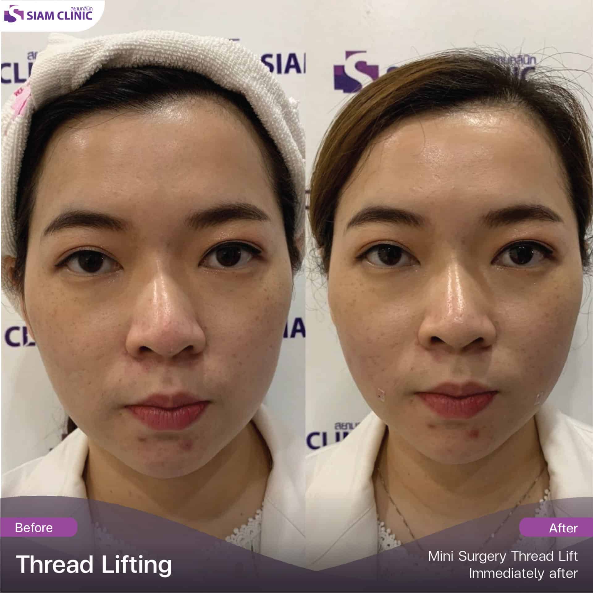 Jawline Thread lifting - Siam Clinic - Aesthetic & Wellness Clinic in ...