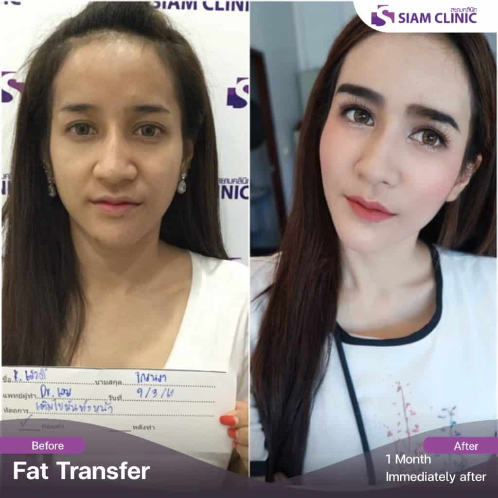 مراجعة حالة نقل الدهون (Fat Transfer Review) - Siam Clinic Phuket คลินิกความงามภูเก็ต