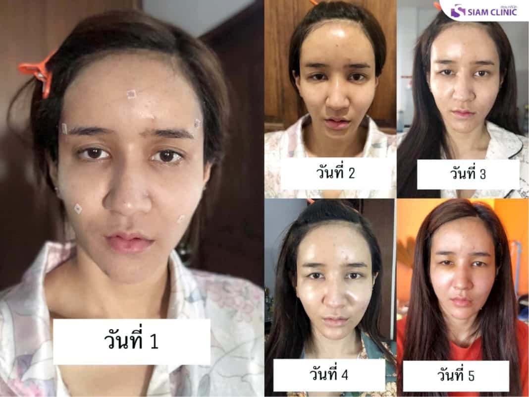 Facial Rejuvenation with Fat transfer - Siam Clinic Phuket