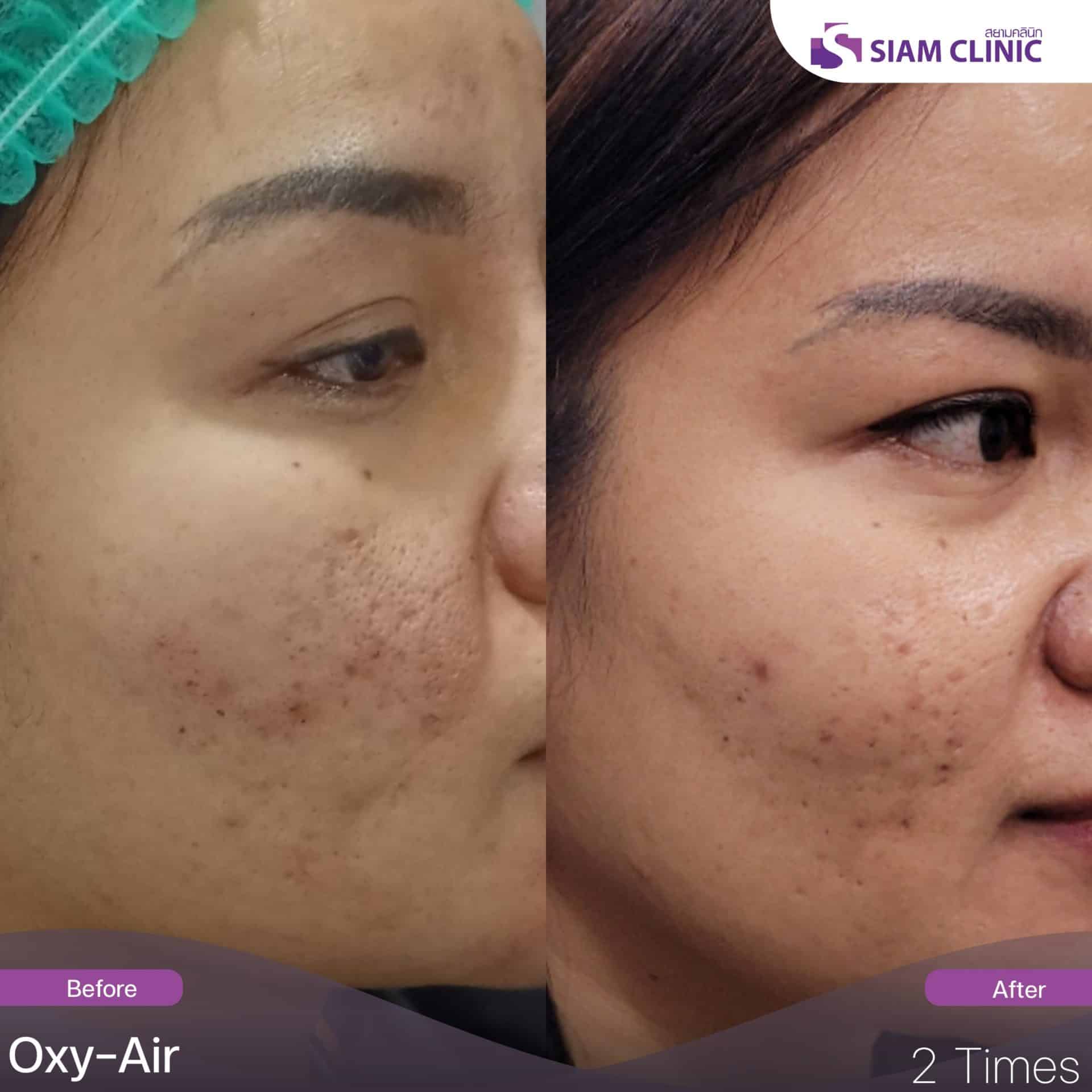 Oxy Air Case Review (Air Dissector) - Siam Clinic - Aesthetic ...
